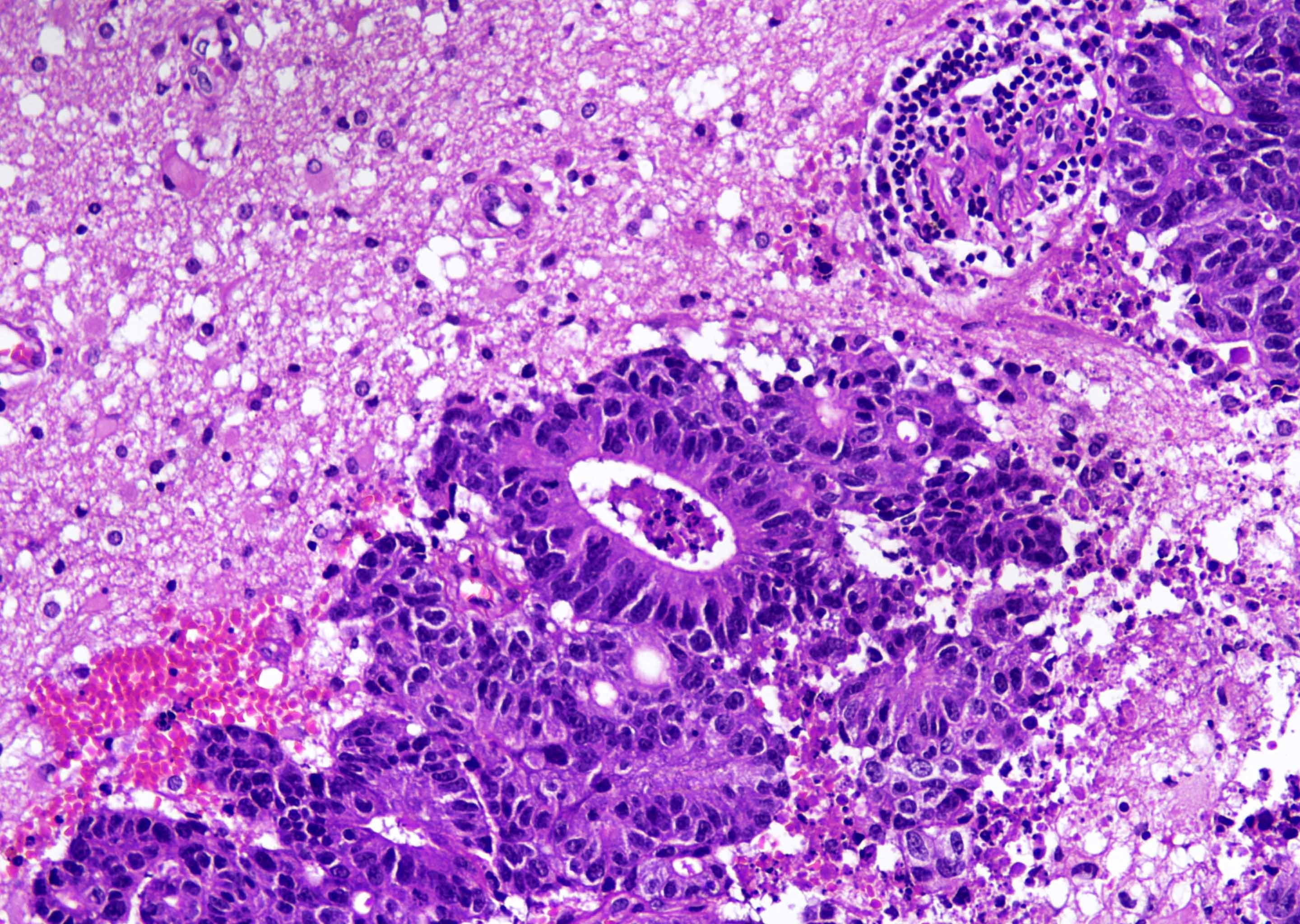Pathology Outlines - Metastases