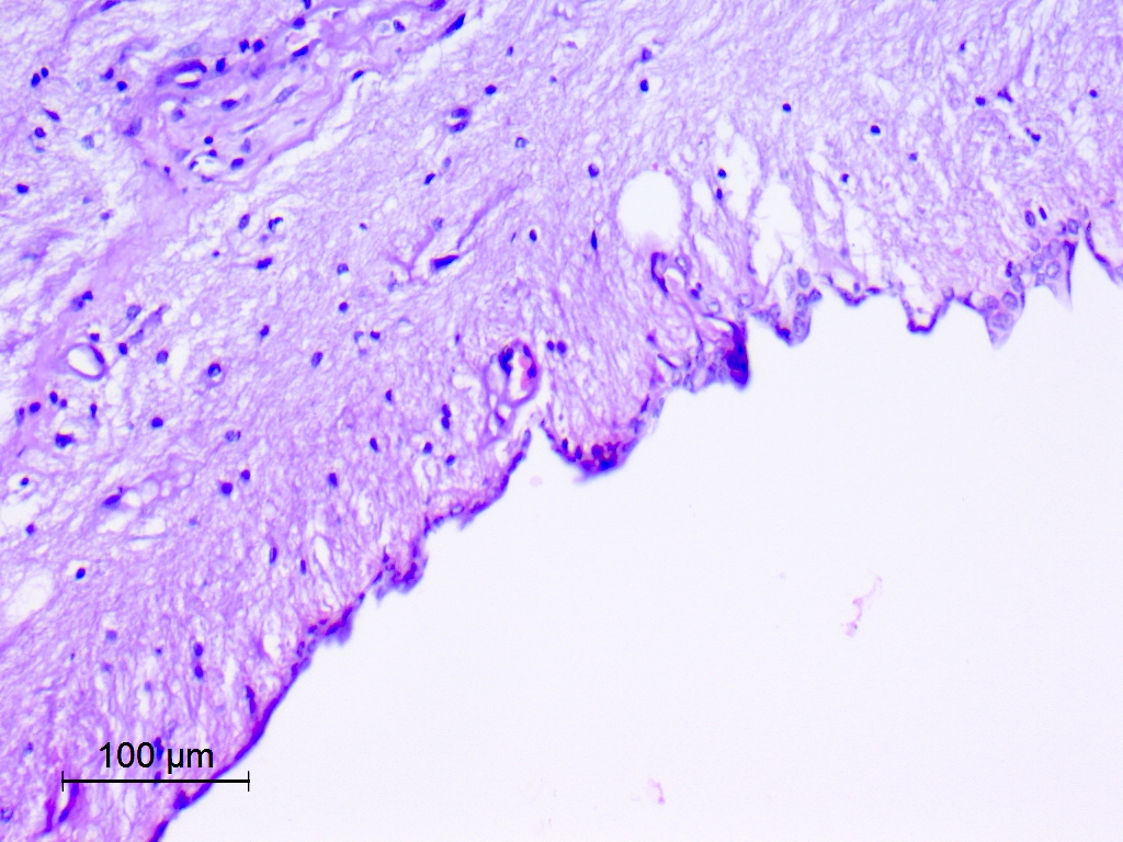 Pathology Outlines - Glioependymal / ependymal cyst