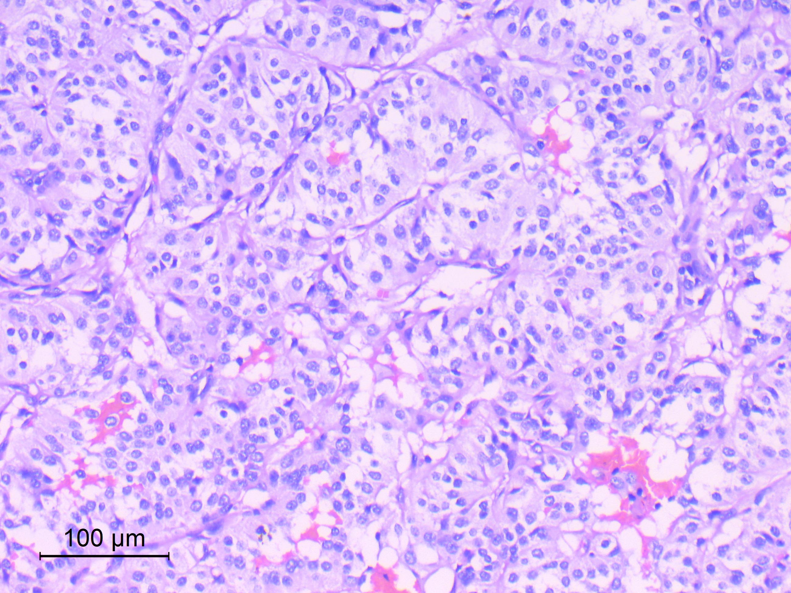 Pathology Outlines - Cauda equina neuroendocrine tumor
