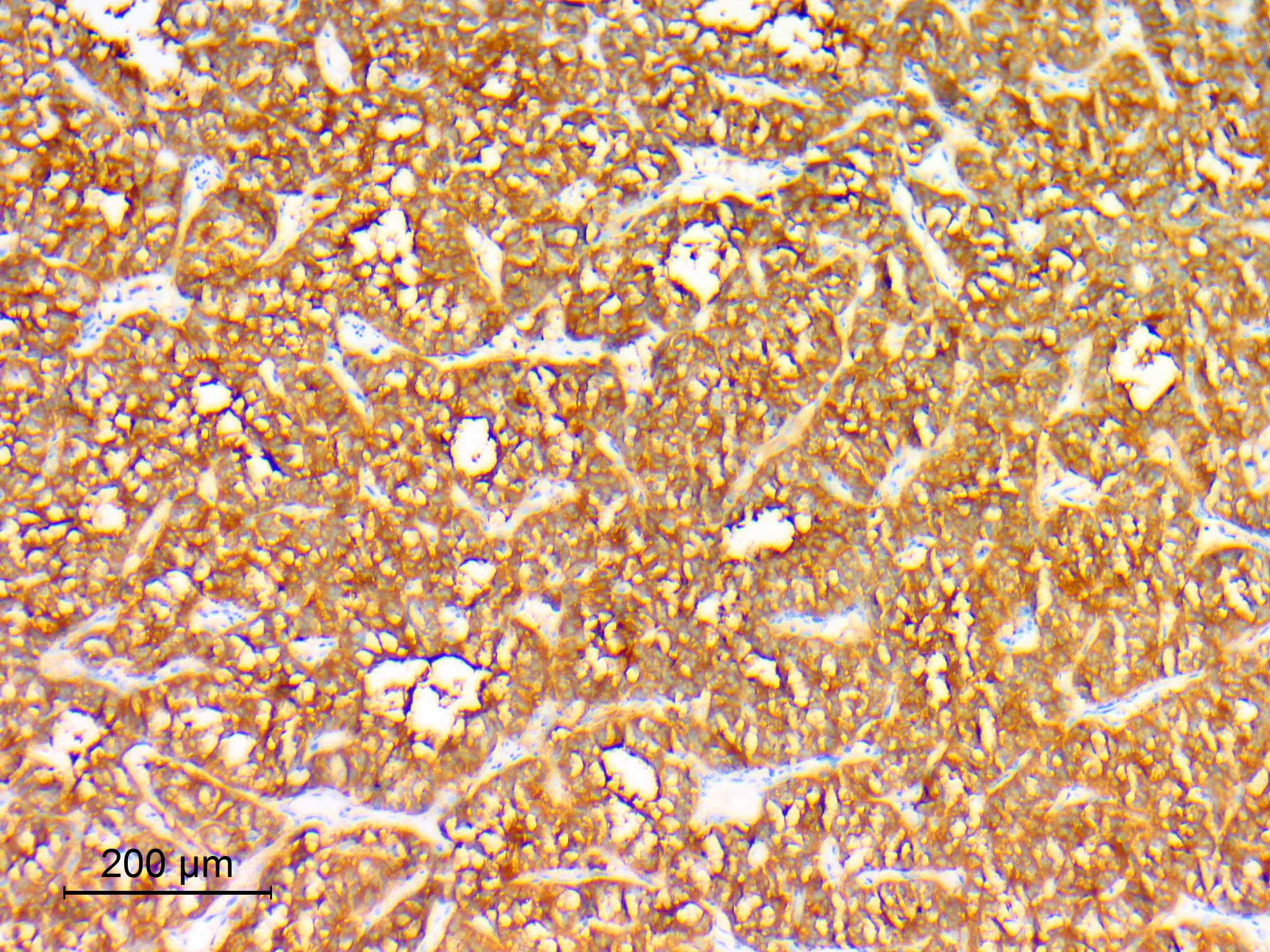 Pathology Outlines - Cauda equina neuroendocrine tumor