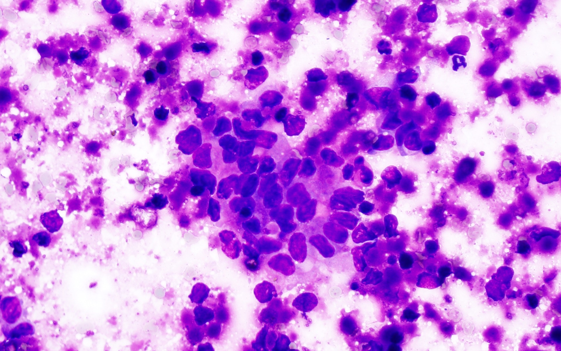 Pathology Outlines - Pineoblastoma
