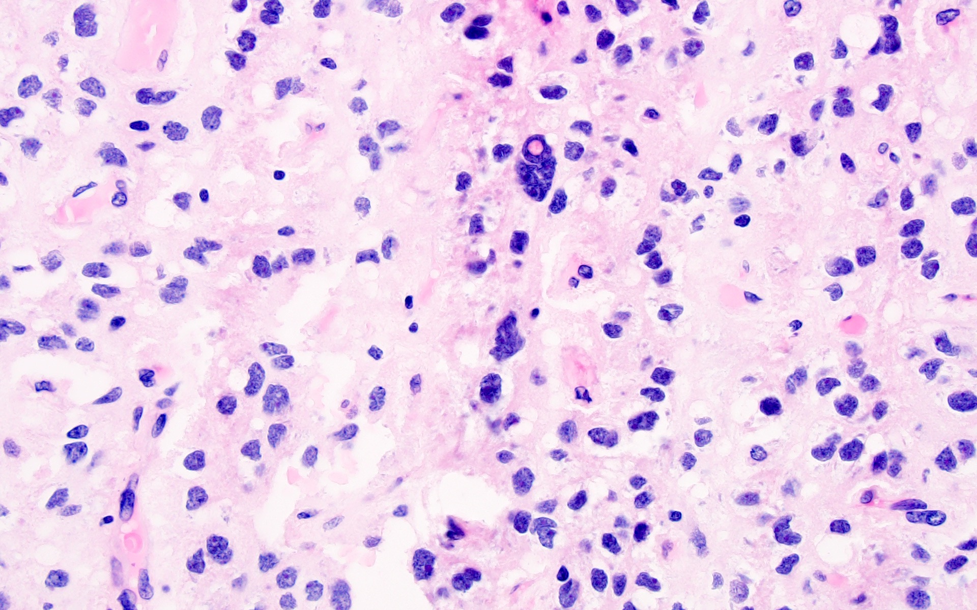 Pathology Outlines - Polymorphous low grade neuroepithelial tumor of ...