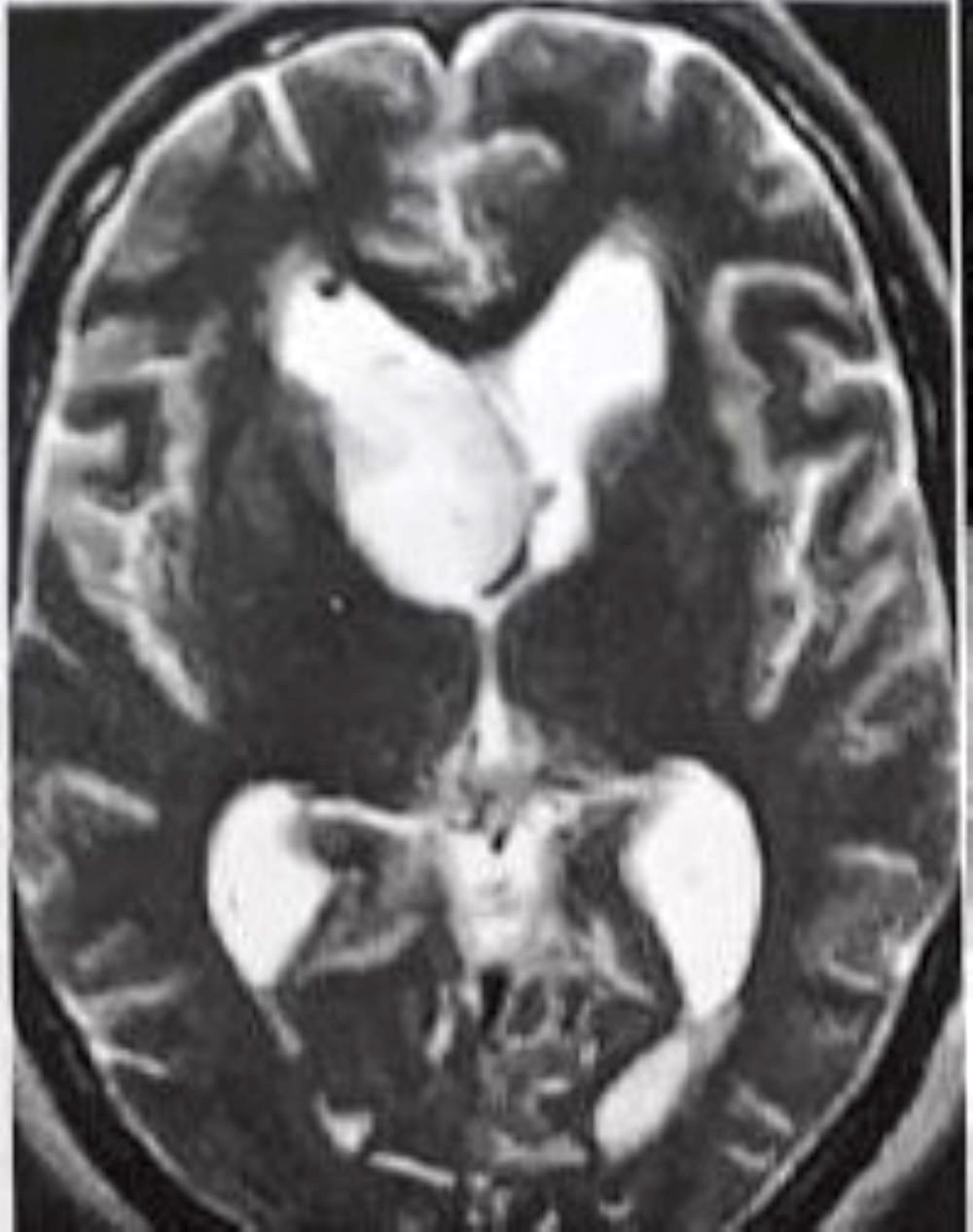 Pathology Outlines - Subependymoma