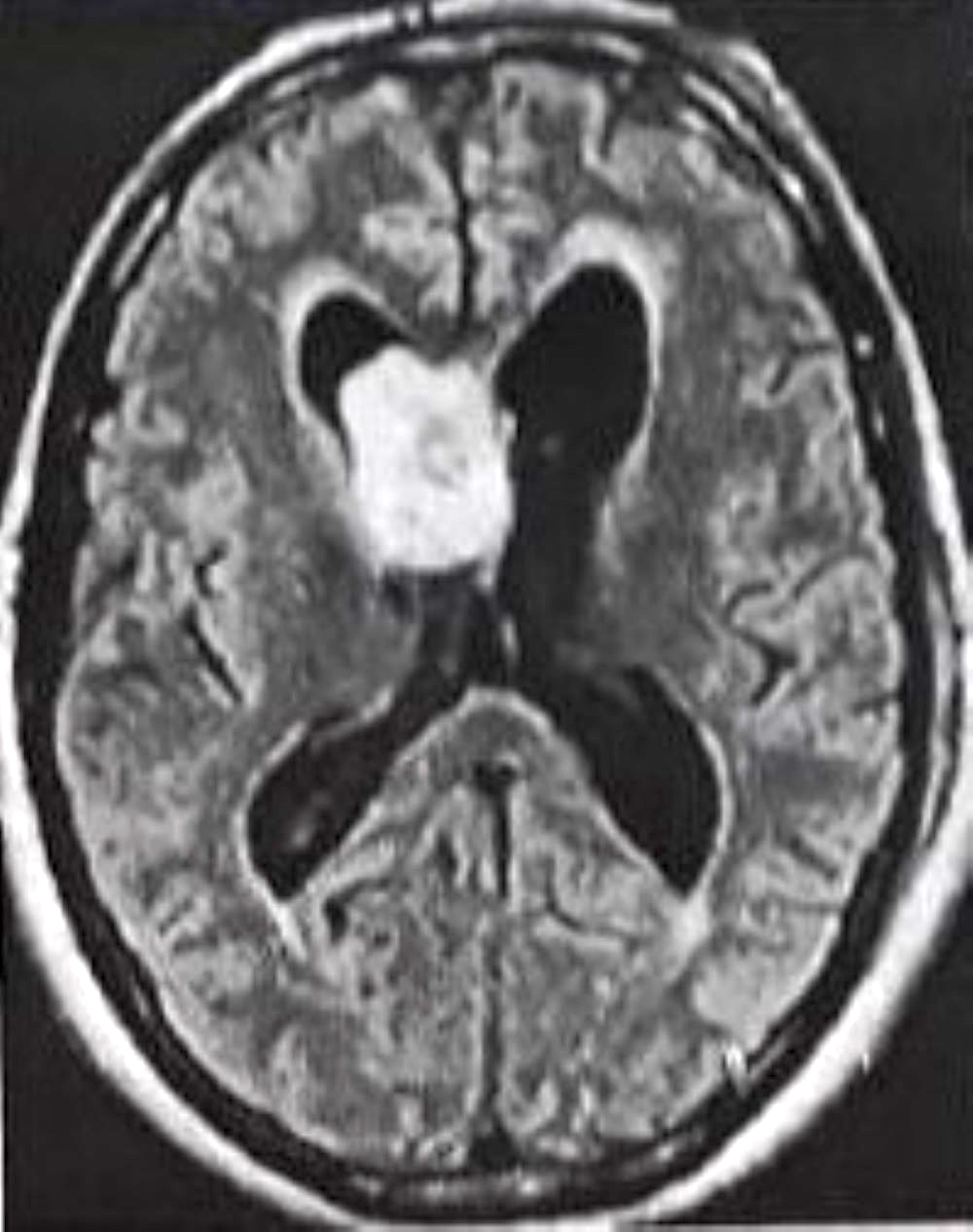 Pathology Outlines - Subependymoma