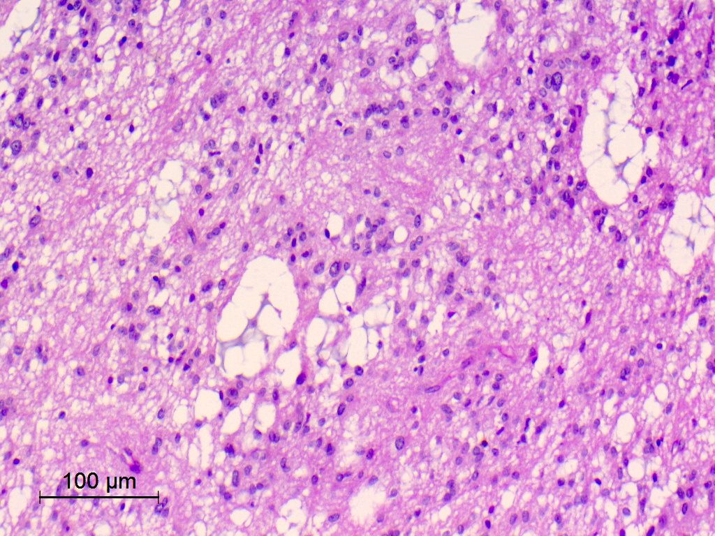 Pathology Outlines - Subependymoma
