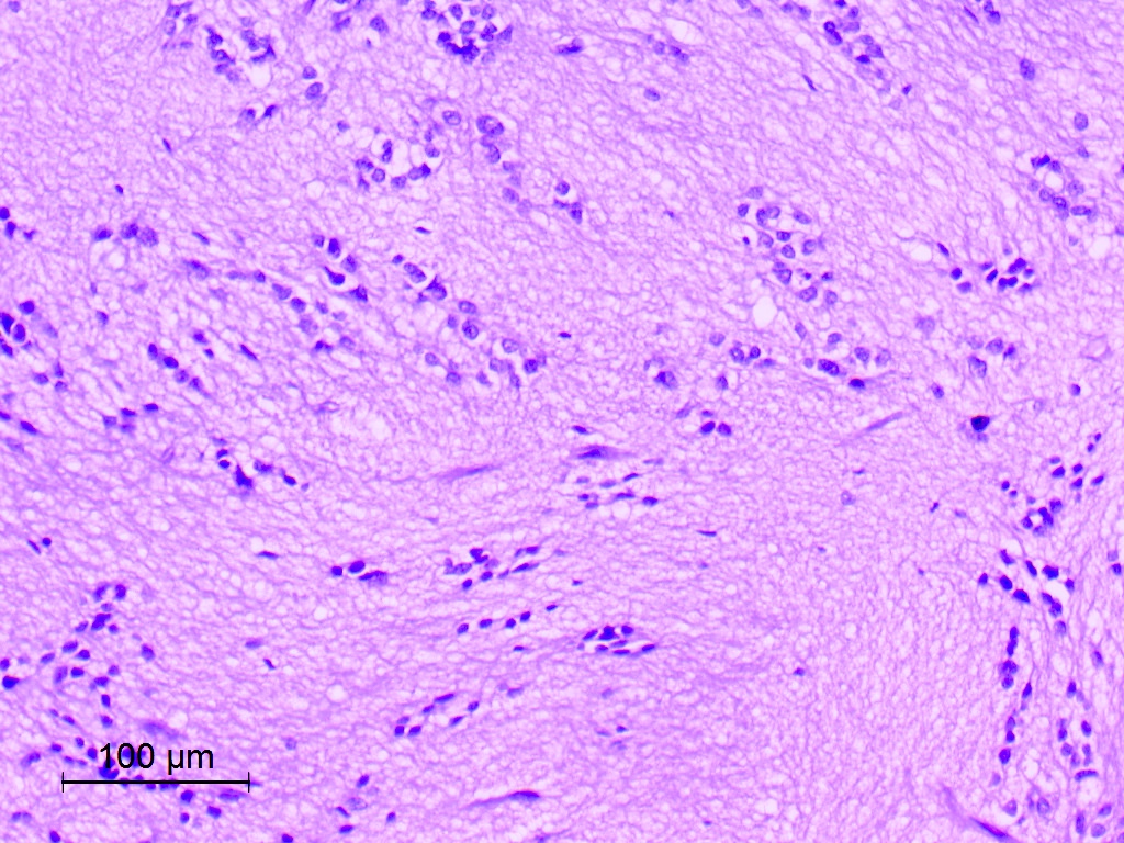 Pathology Outlines - Subependymoma