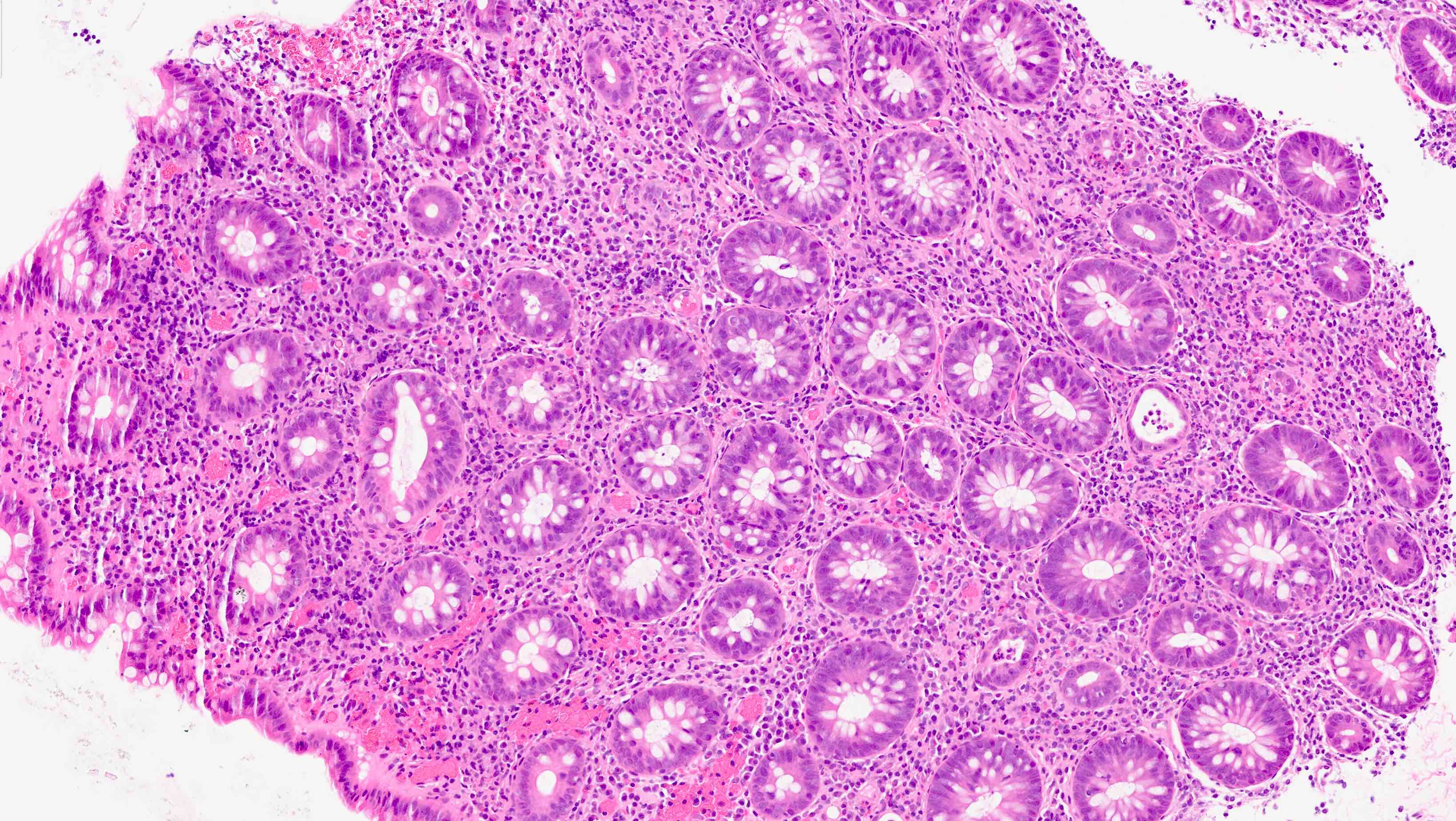 Noninfectious Colitis