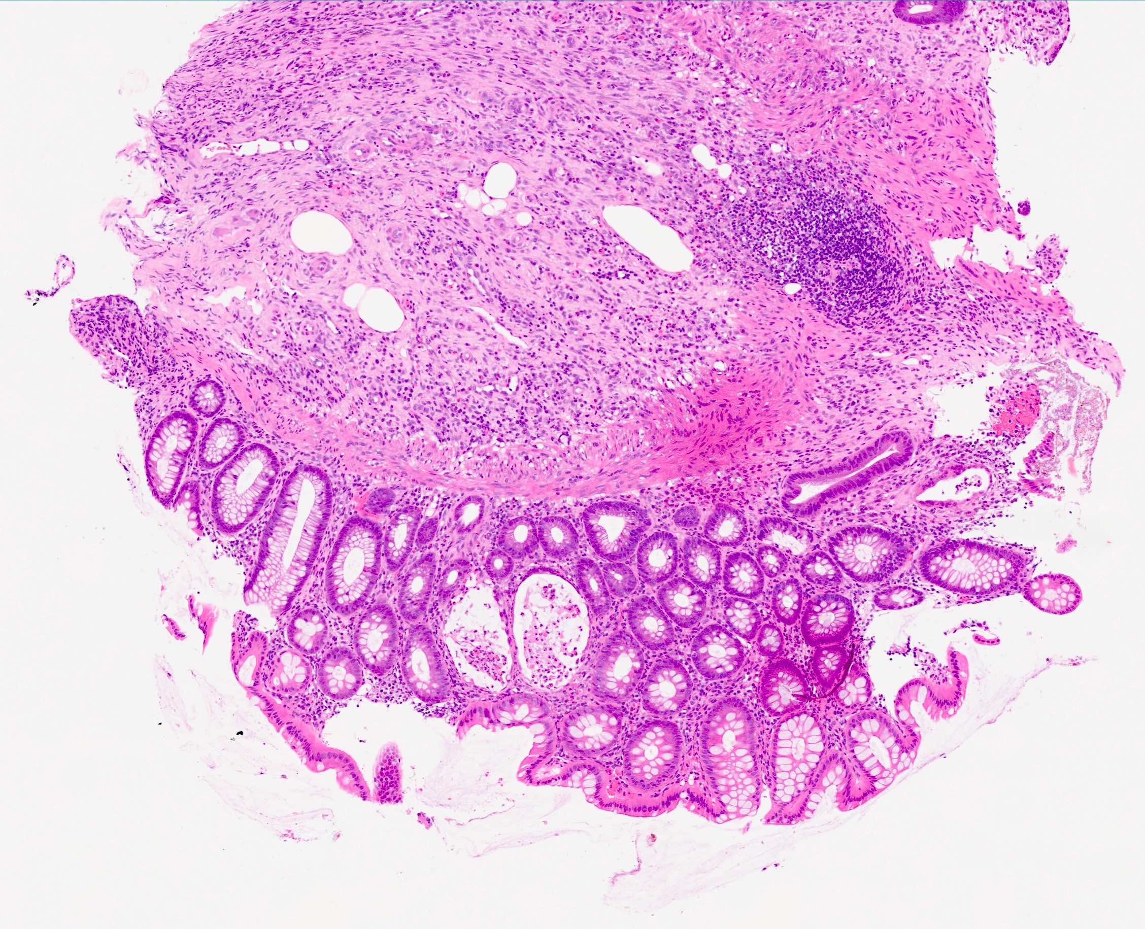 Pathology Outlines - Focal active colitis