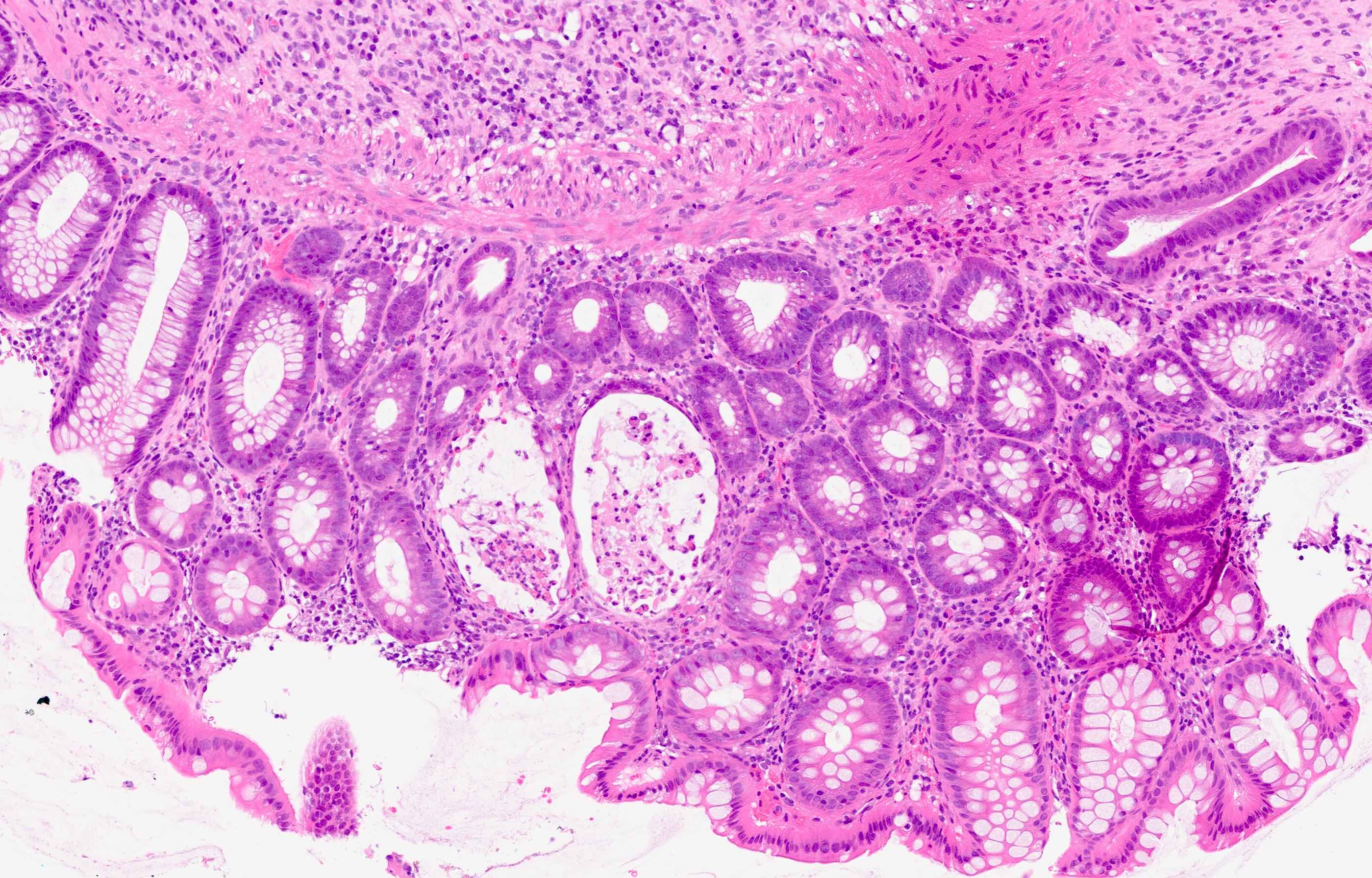 Pathology Outlines - Focal active colitis