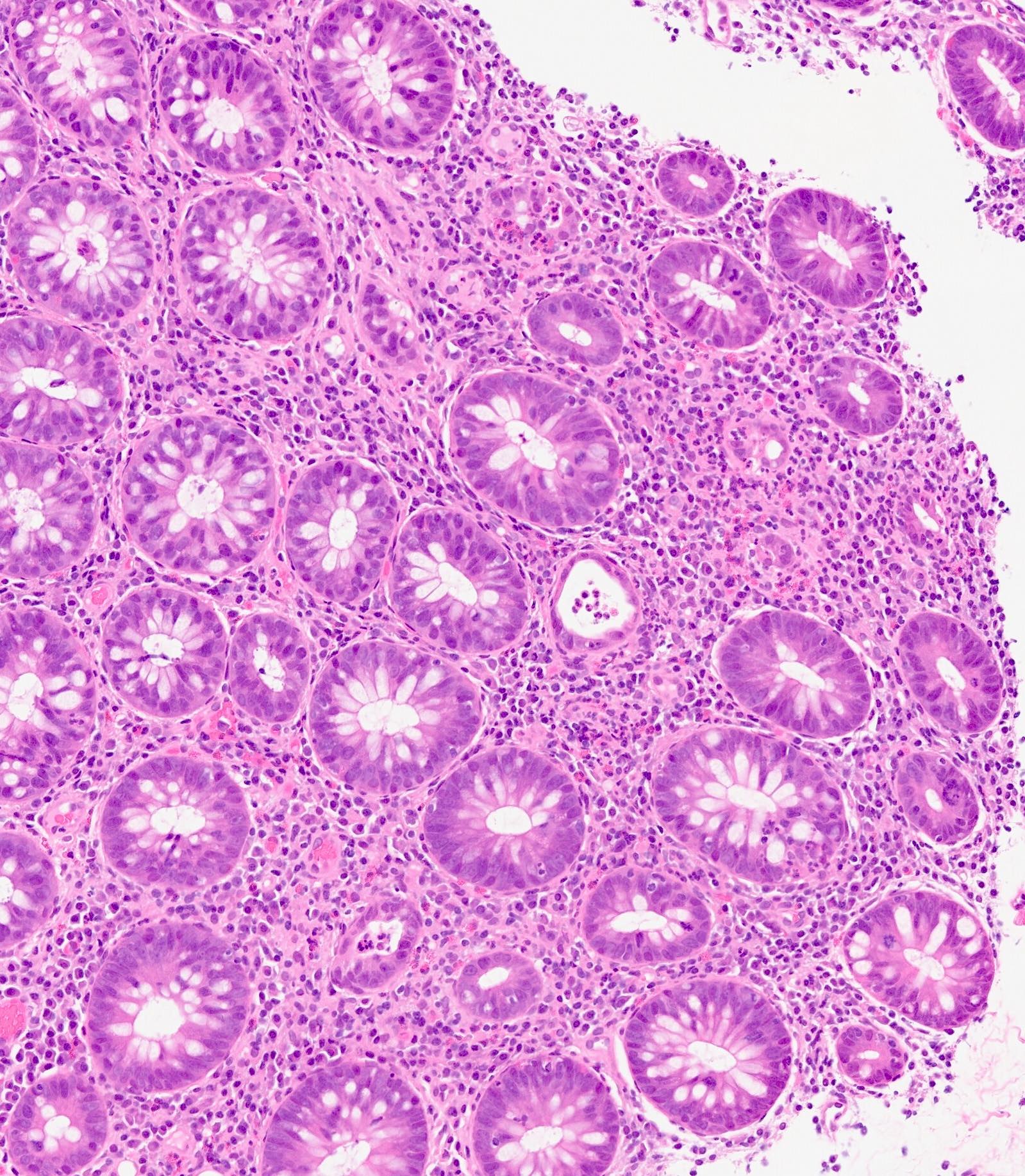 Pathology Outlines - Focal active colitis