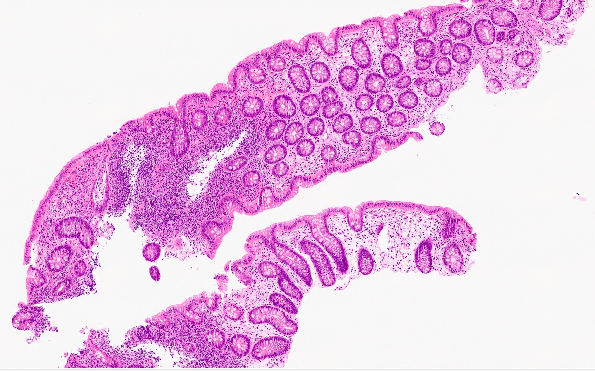 Pathology Outlines - Focal active colitis