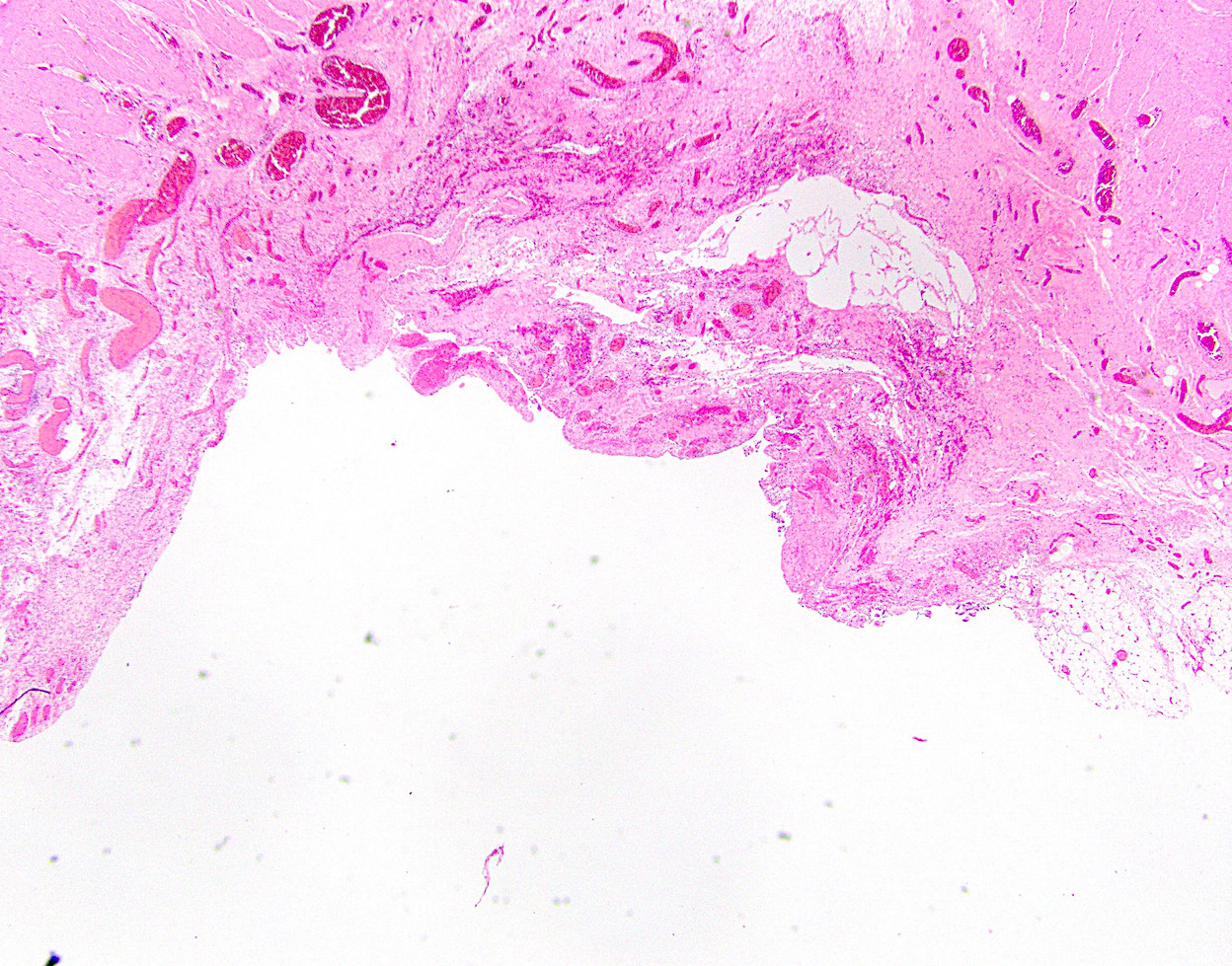 Pathology Outlines - Adhesions