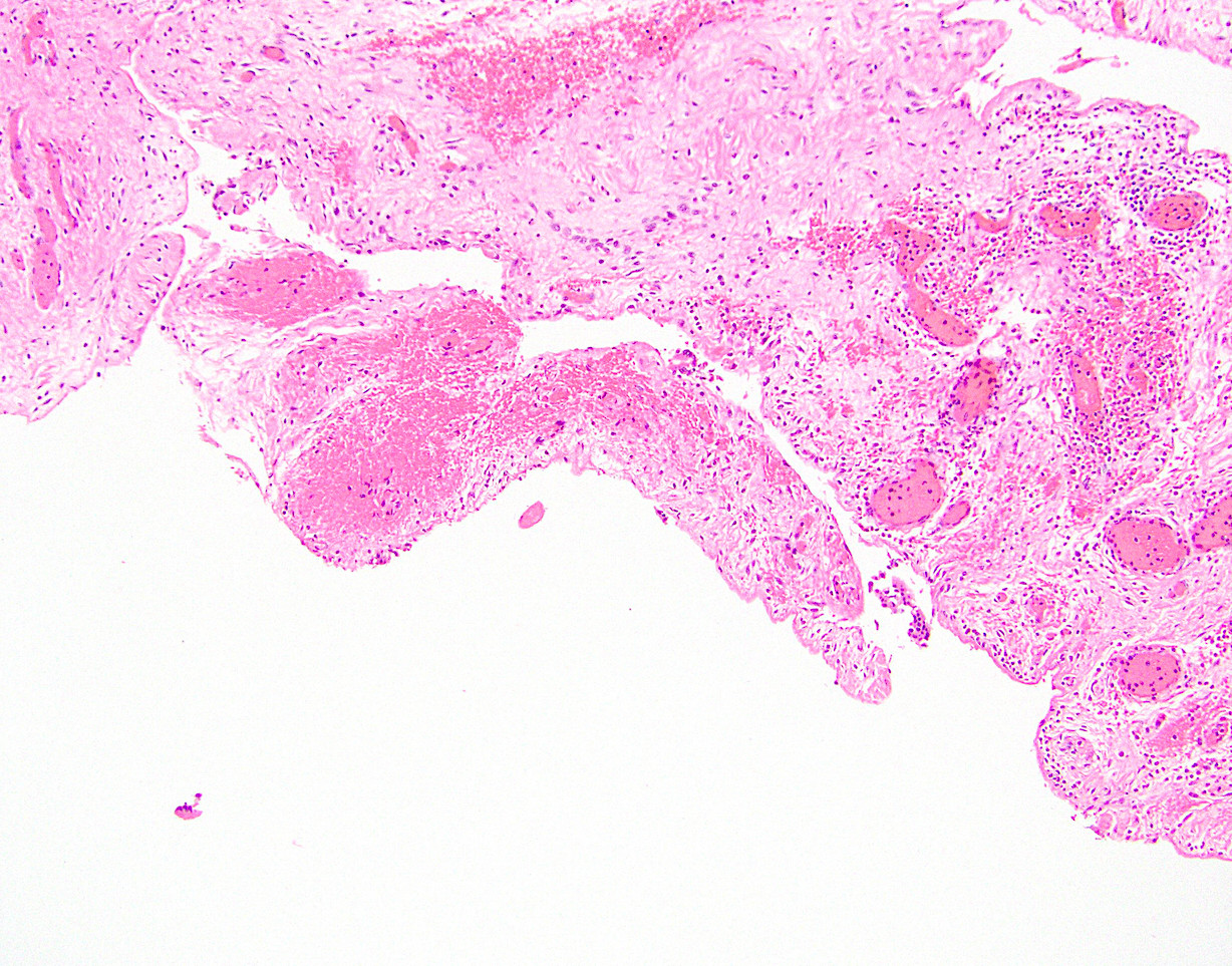 Pathology Outlines - Adhesions