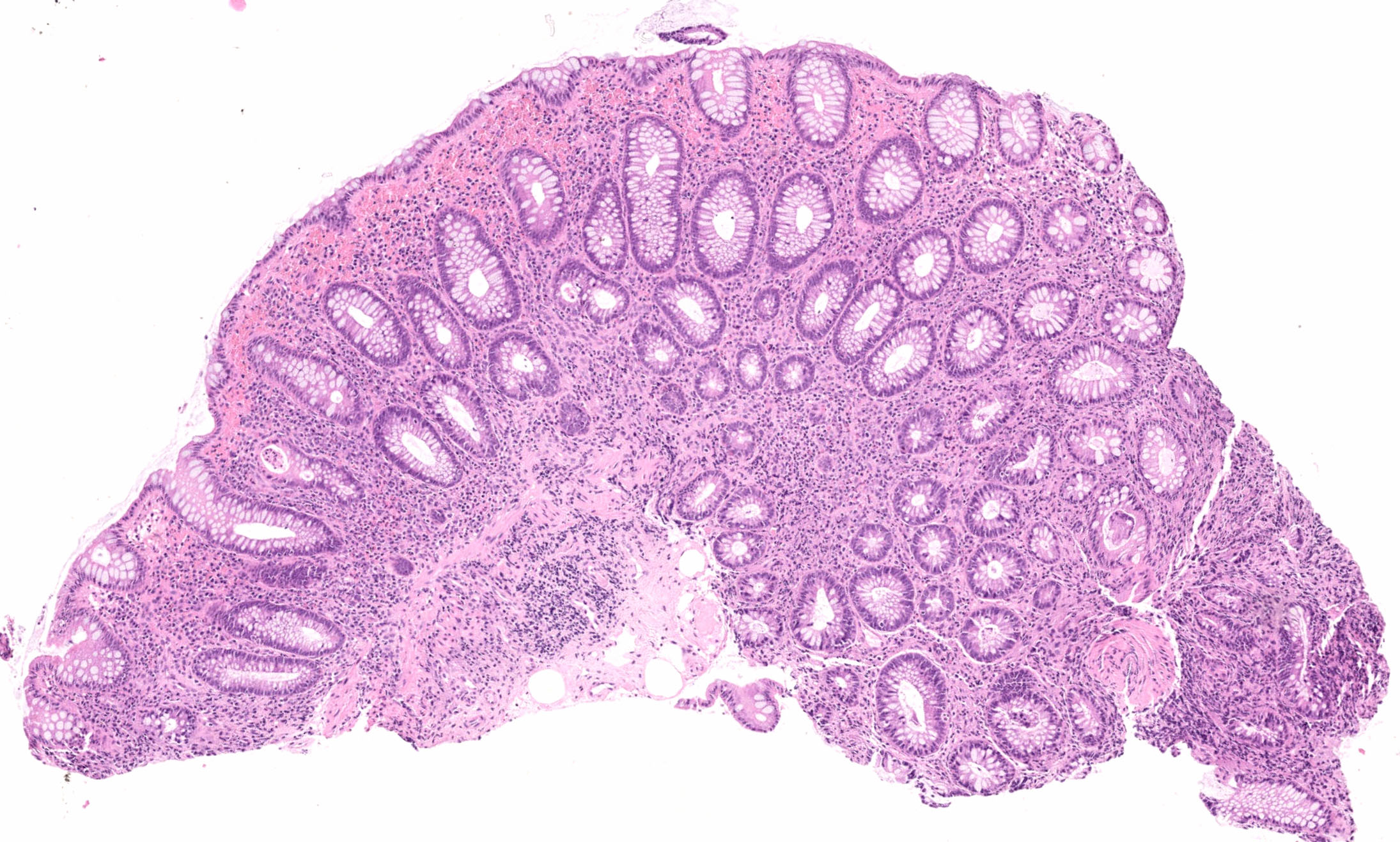 Pathology Outlines - Segmental colitis associated with diverticula (SCAD)