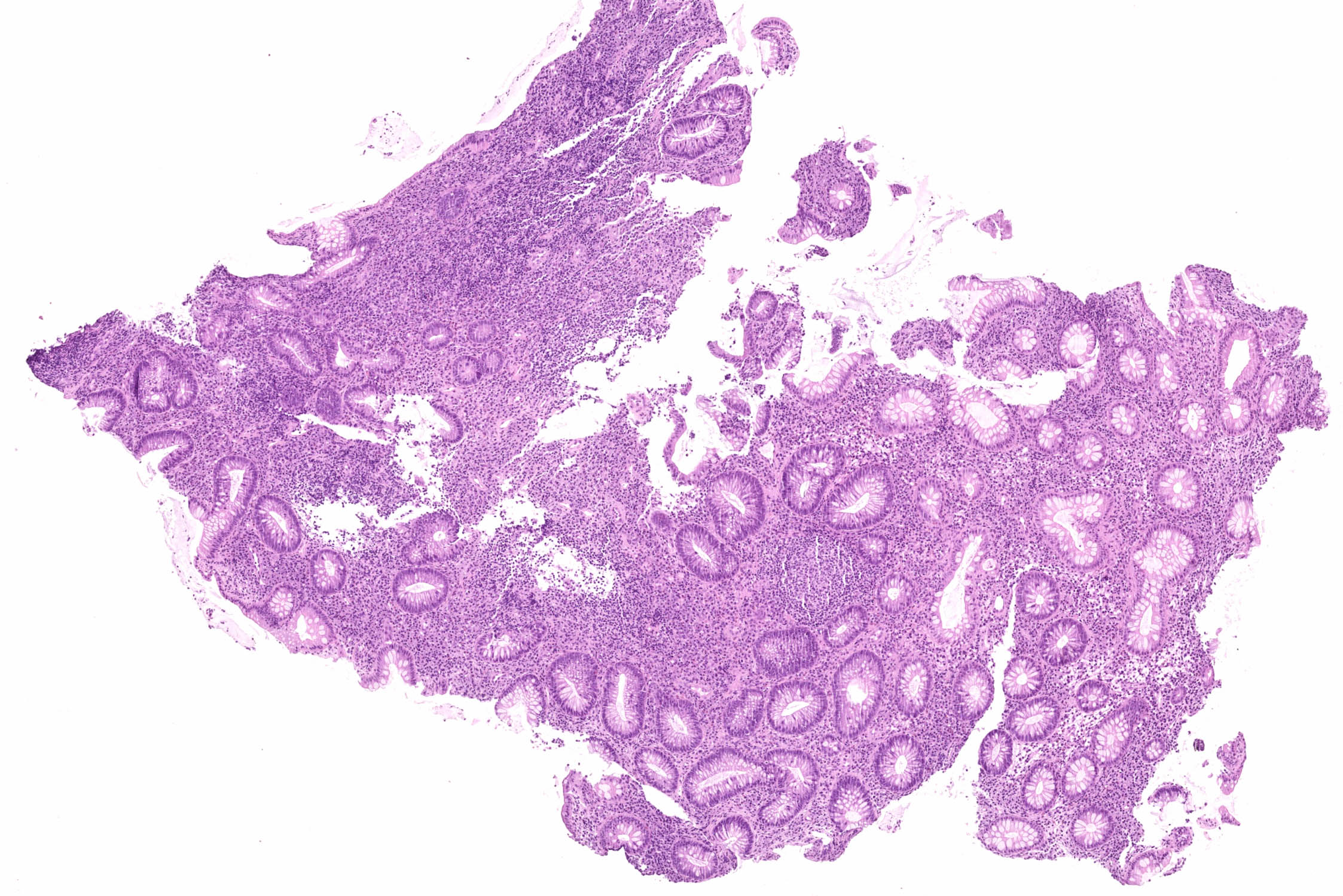 Pathology Outlines - Segmental colitis associated with diverticula (SCAD)