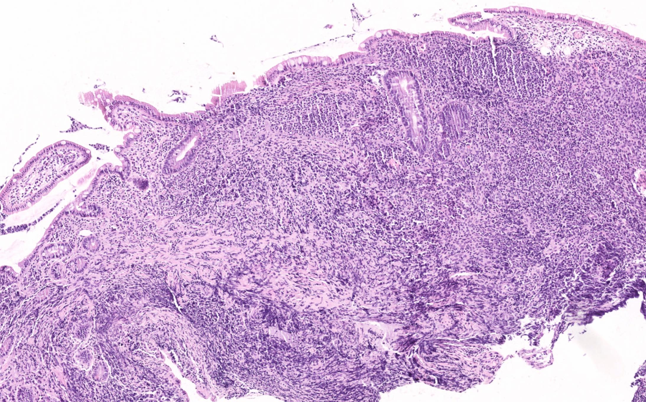Pathology Outlines - Segmental colitis associated with diverticula (SCAD)
