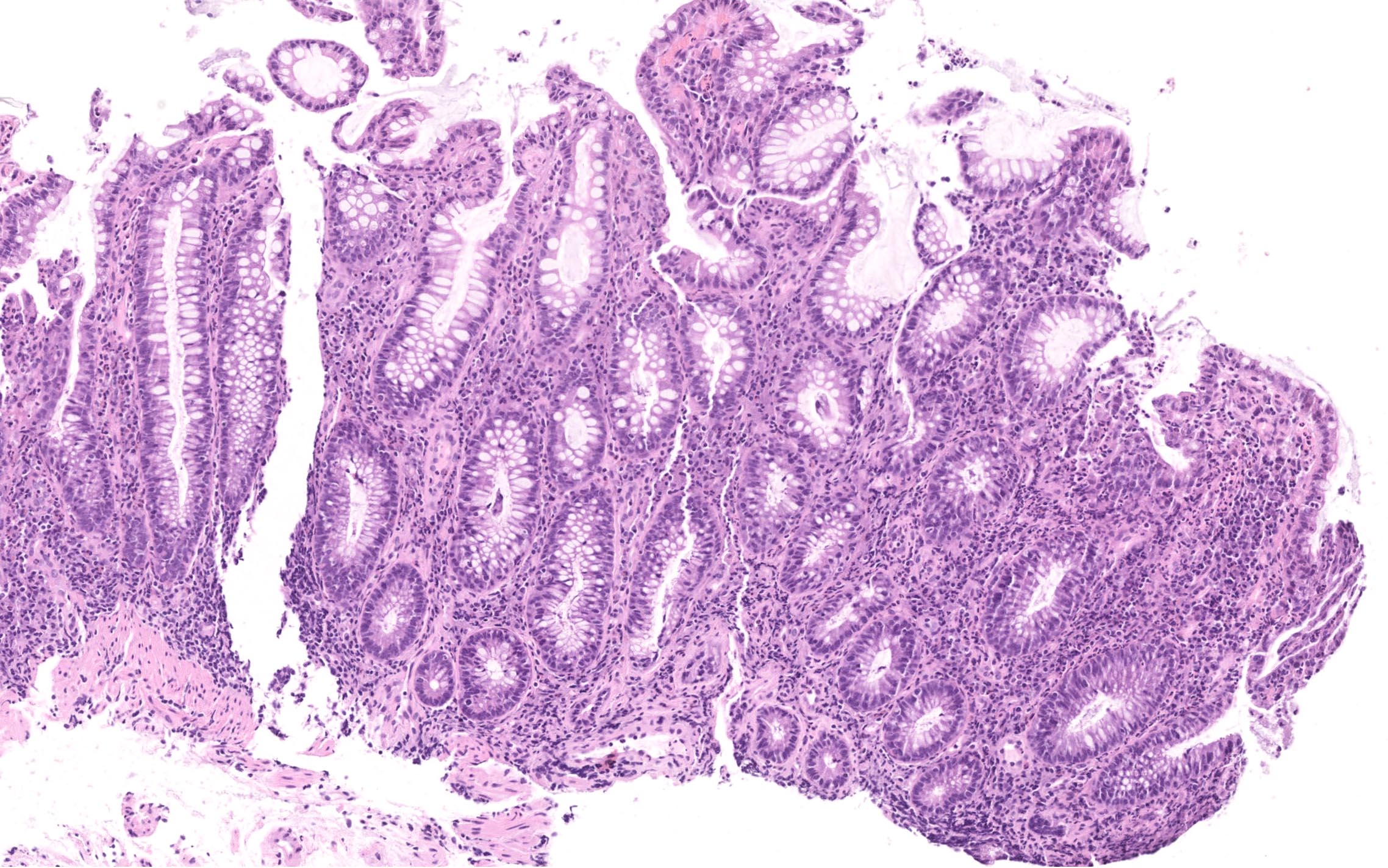 Pathology Outlines - Segmental colitis associated with diverticula (SCAD)