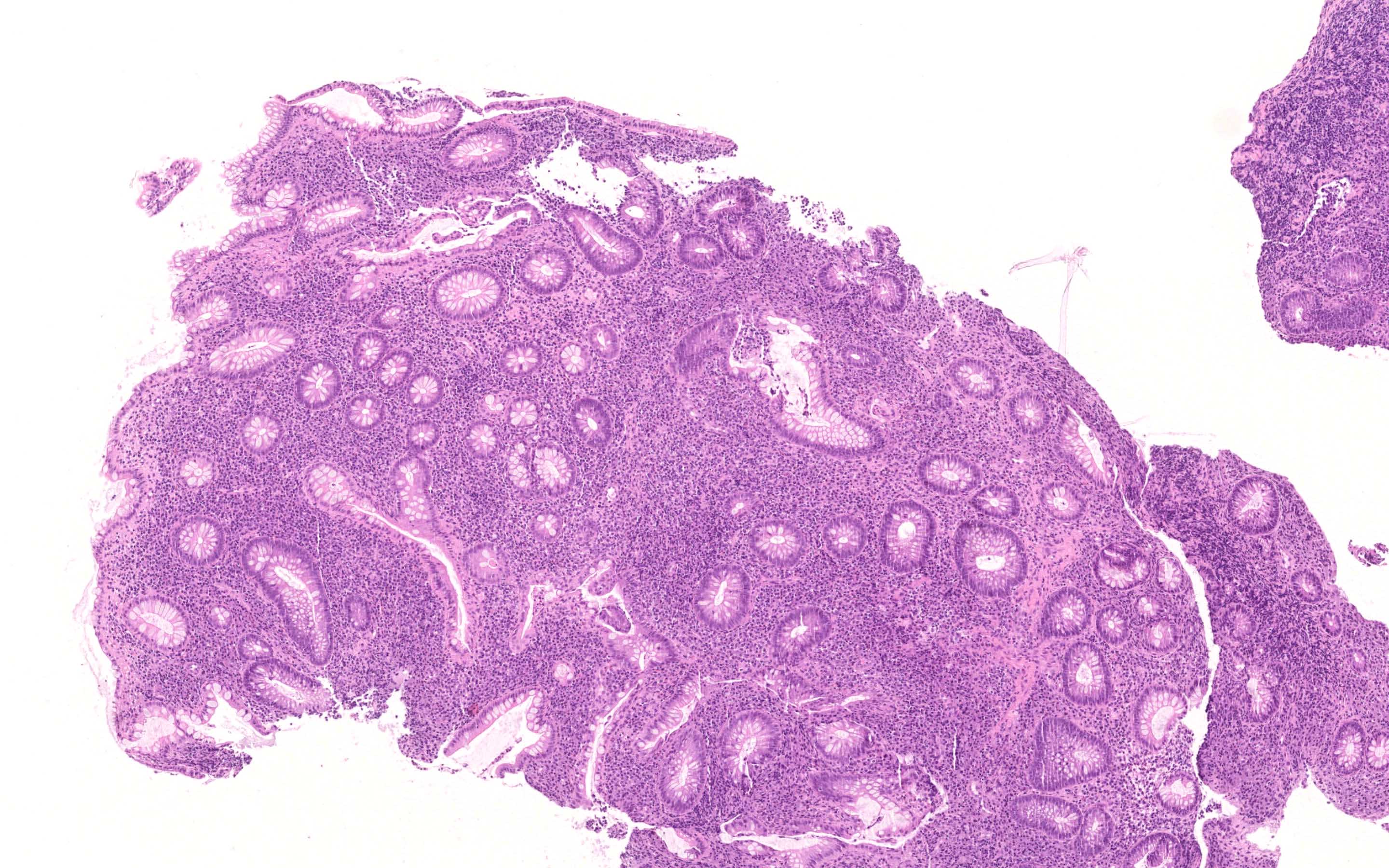 Pathology Outlines - Segmental colitis associated with diverticula (SCAD)