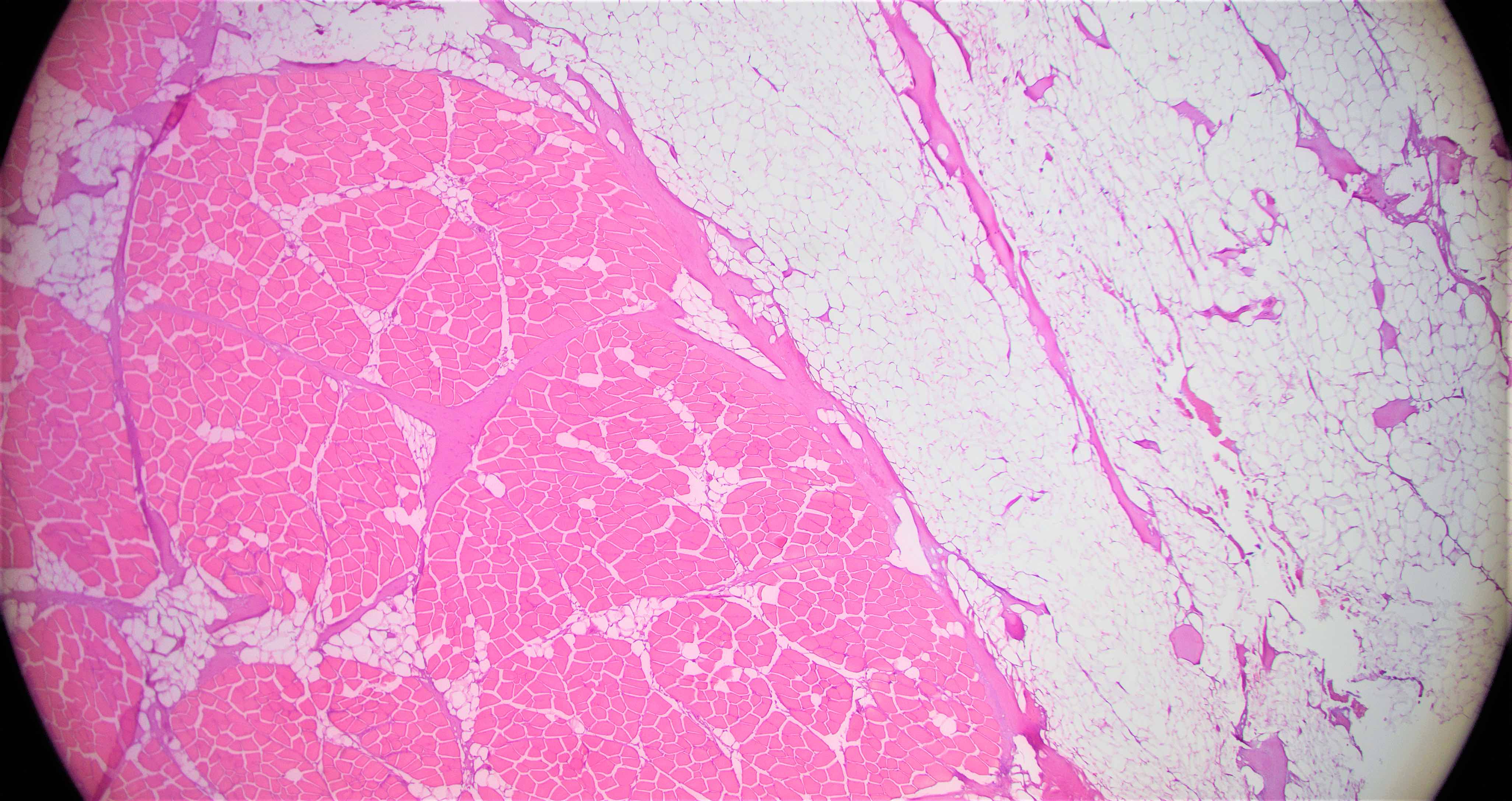 Pathology Outlines - Foreign materials / food