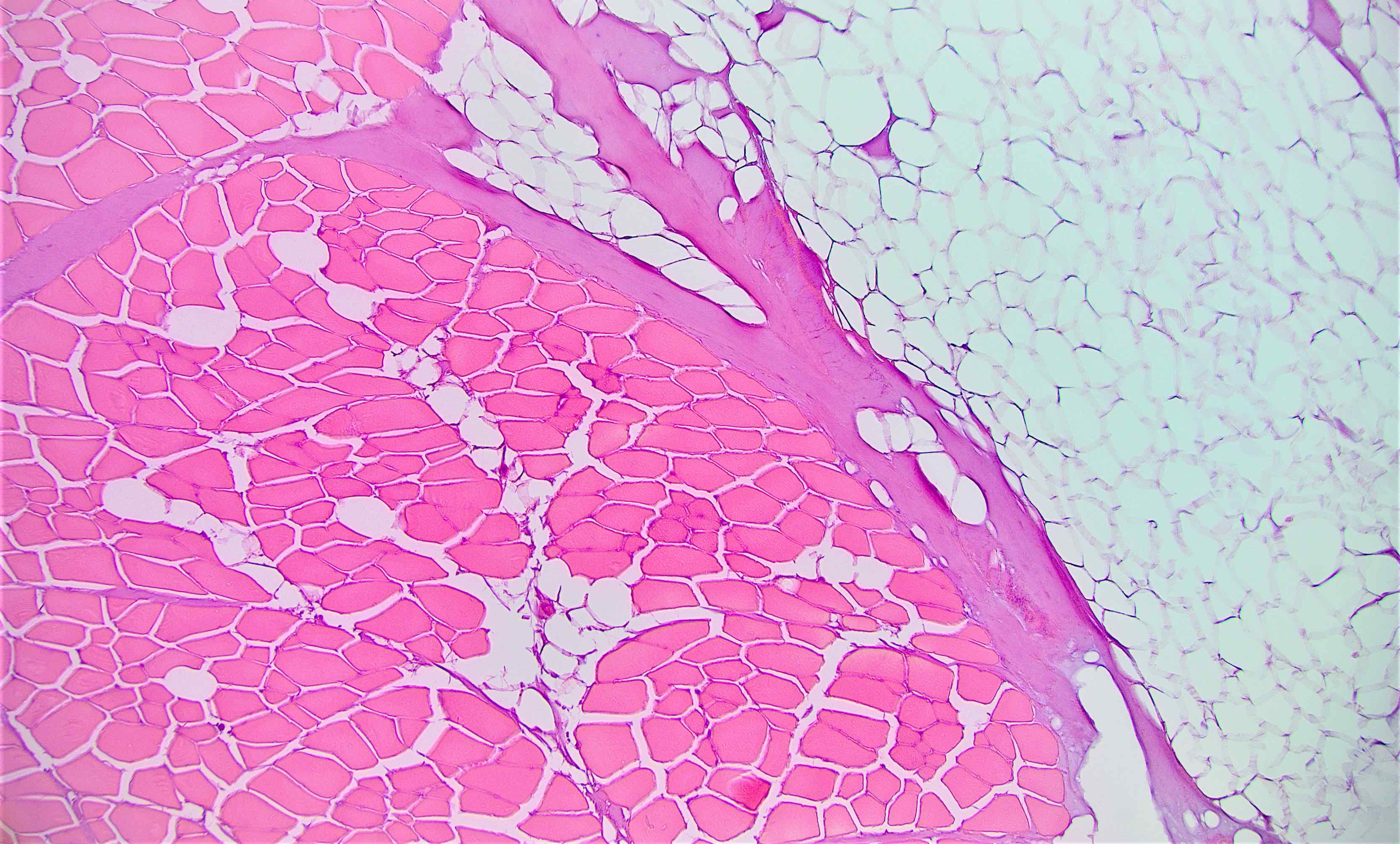 Pathology Outlines - Foreign materials / food
