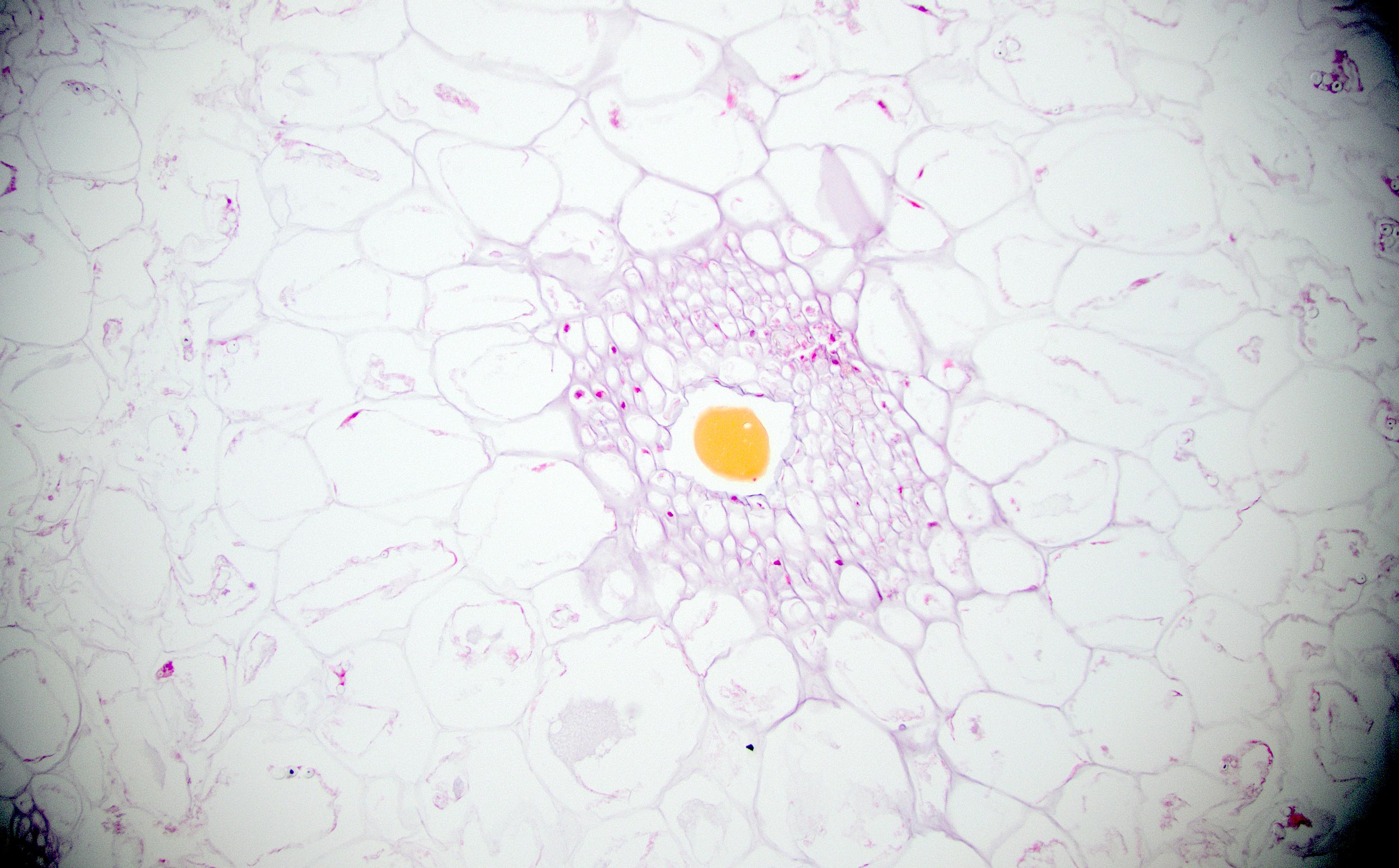 Pathology Outlines - Foreign materials / food