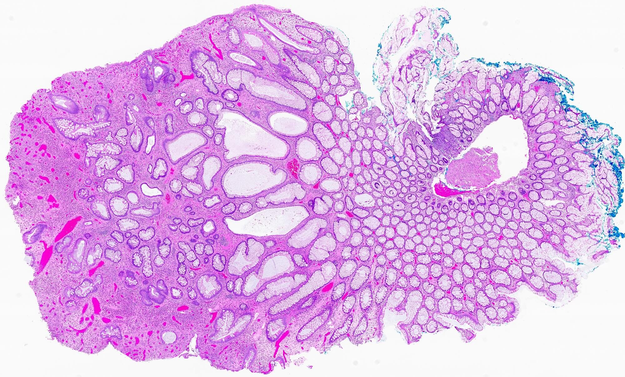Pathology Outlines - Hereditary mixed polyposis syndrome