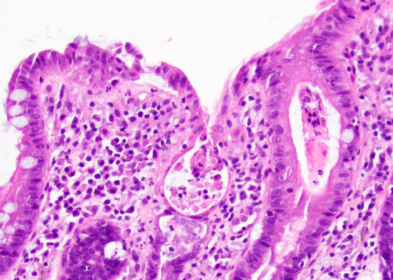 Pathology Outlines - Idelalisib associated