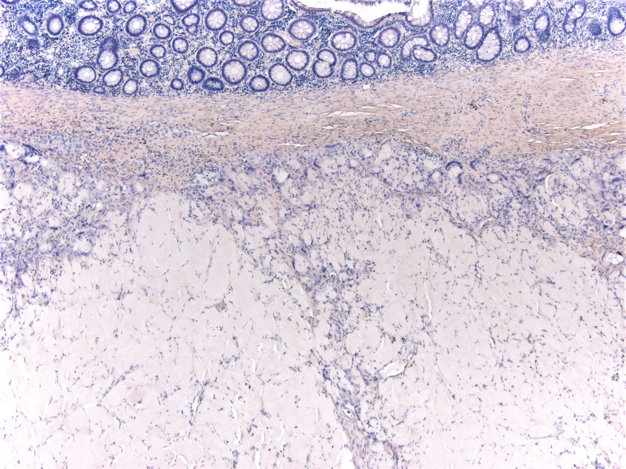 Pathology Outlines - Lifting agent granuloma
