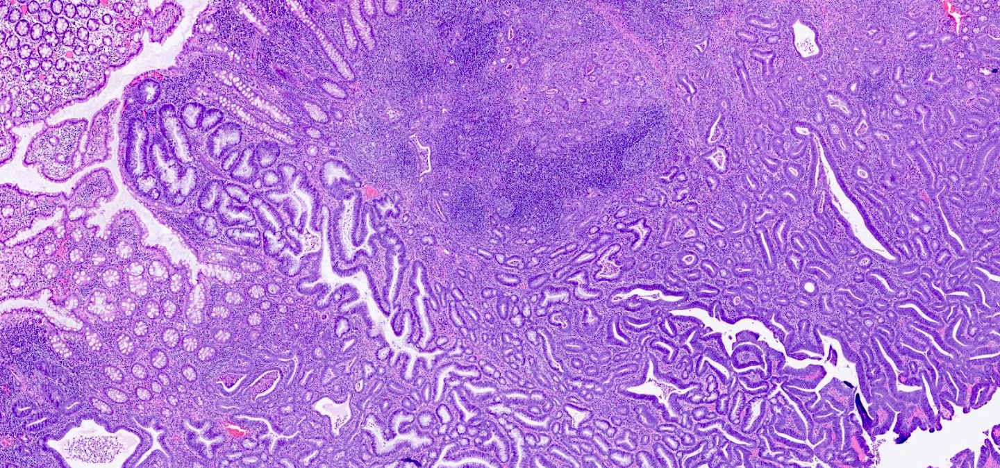 Pathology Outlines - Lymphoglandular complex-like colorectal carcinoma