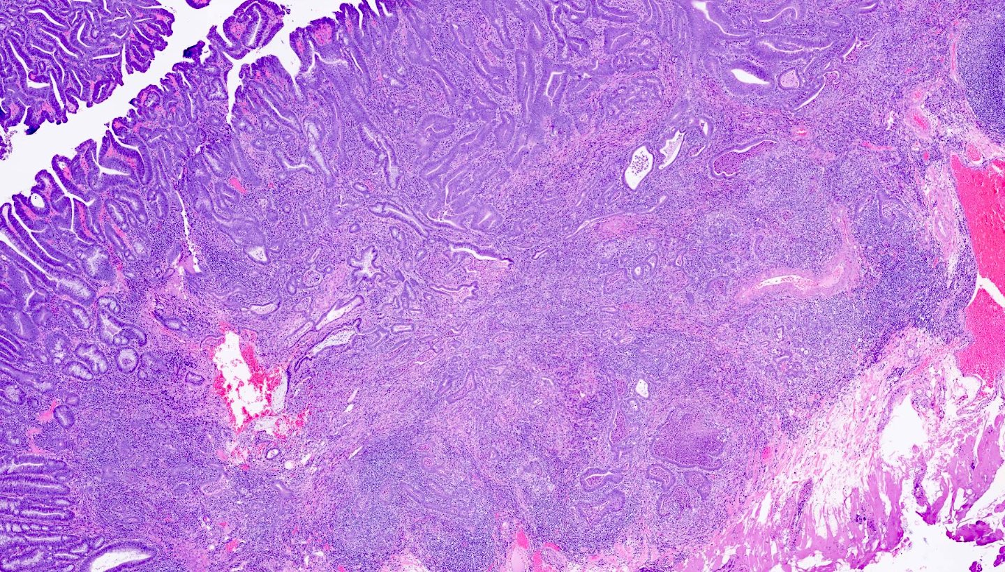 Pathology Outlines - Lymphoglandular complex-like colorectal carcinoma