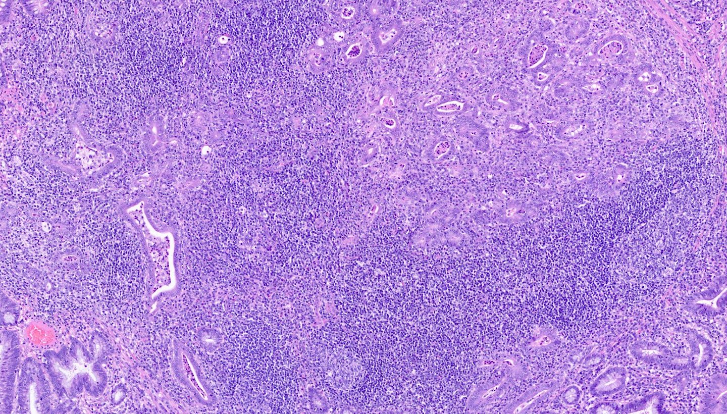 Pathology Outlines - Lymphoglandular complex-like colorectal carcinoma