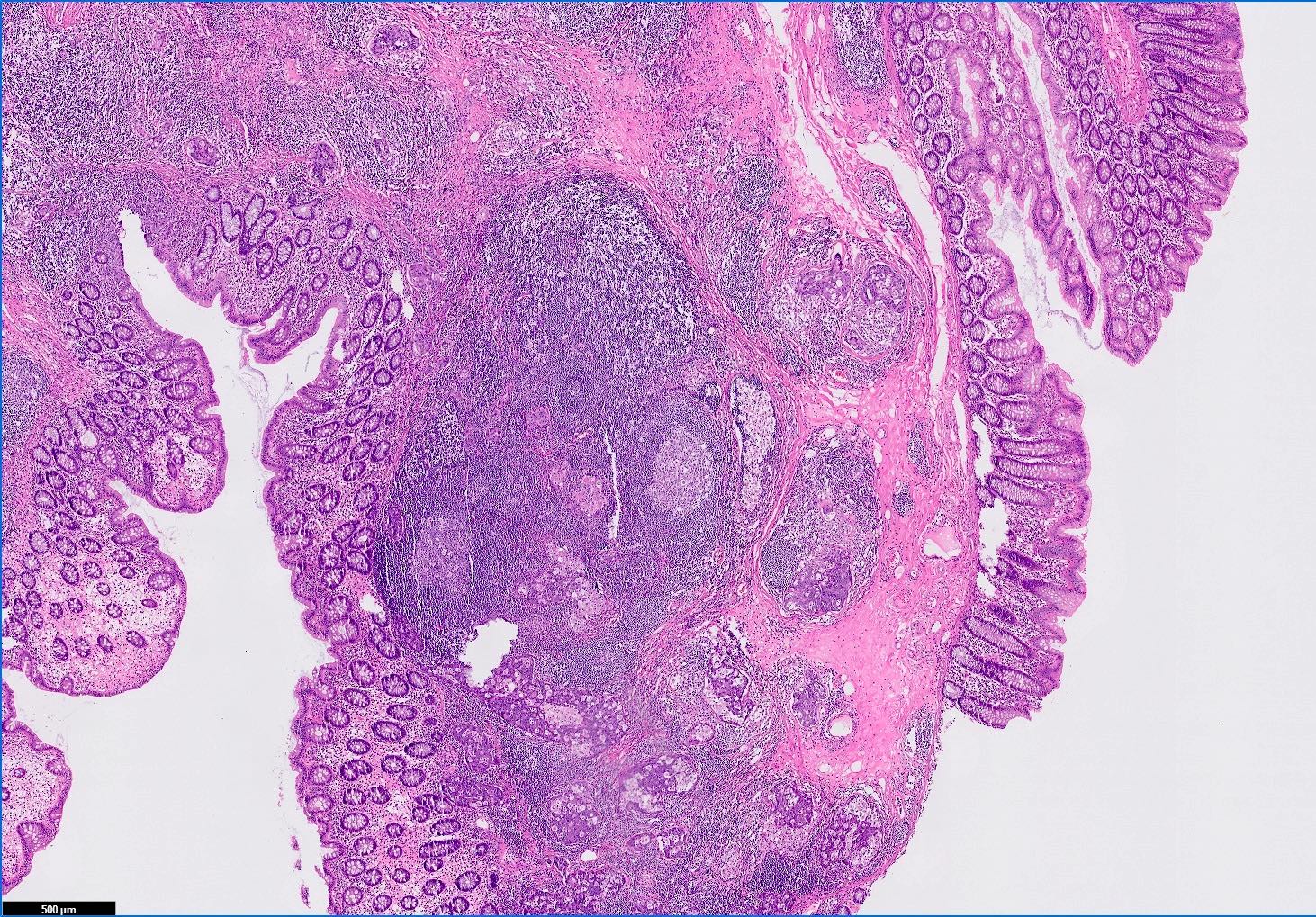 Pathology Outlines - Lymphoglandular complex-like colorectal carcinoma