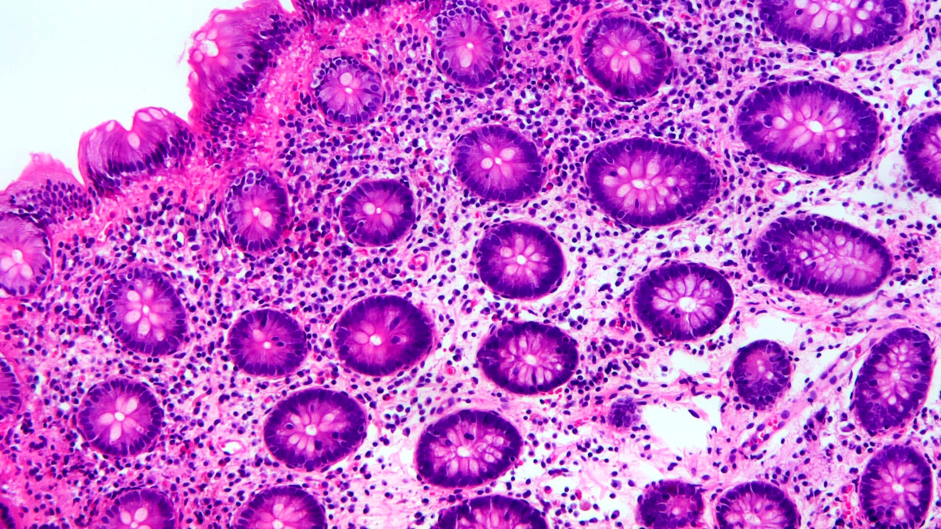 Pathology Outlines - Mast cell disorders