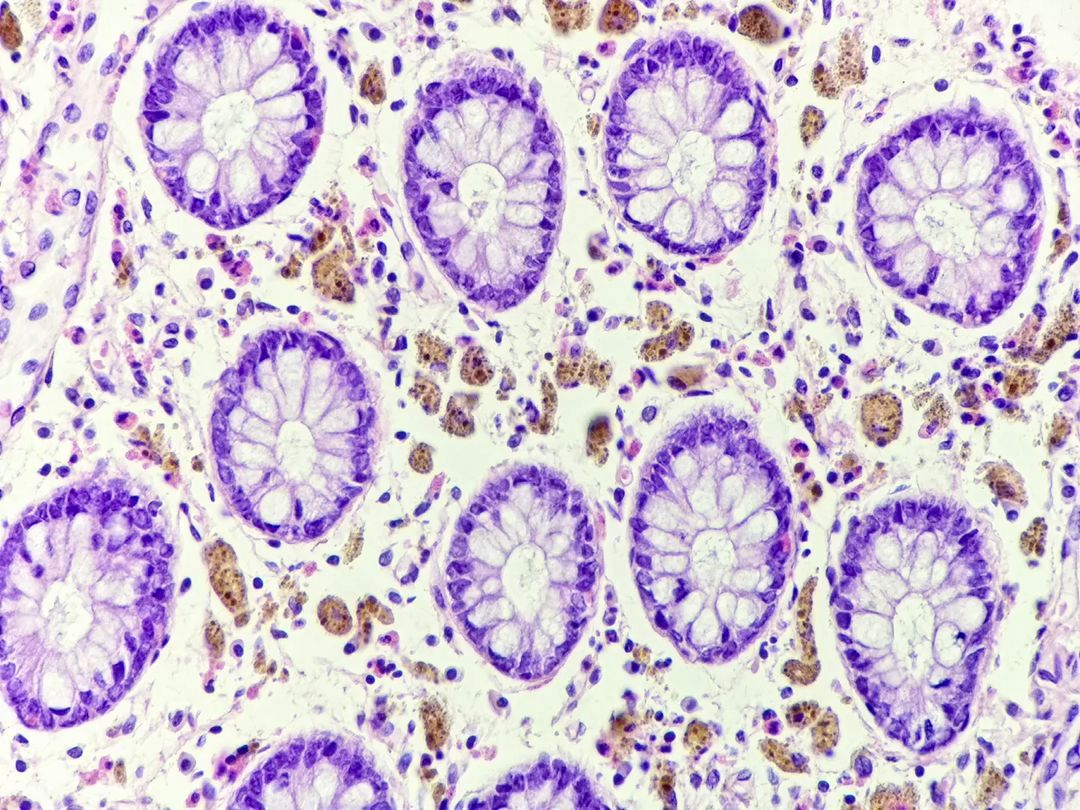 Pathology Outlines - Melanosis coli