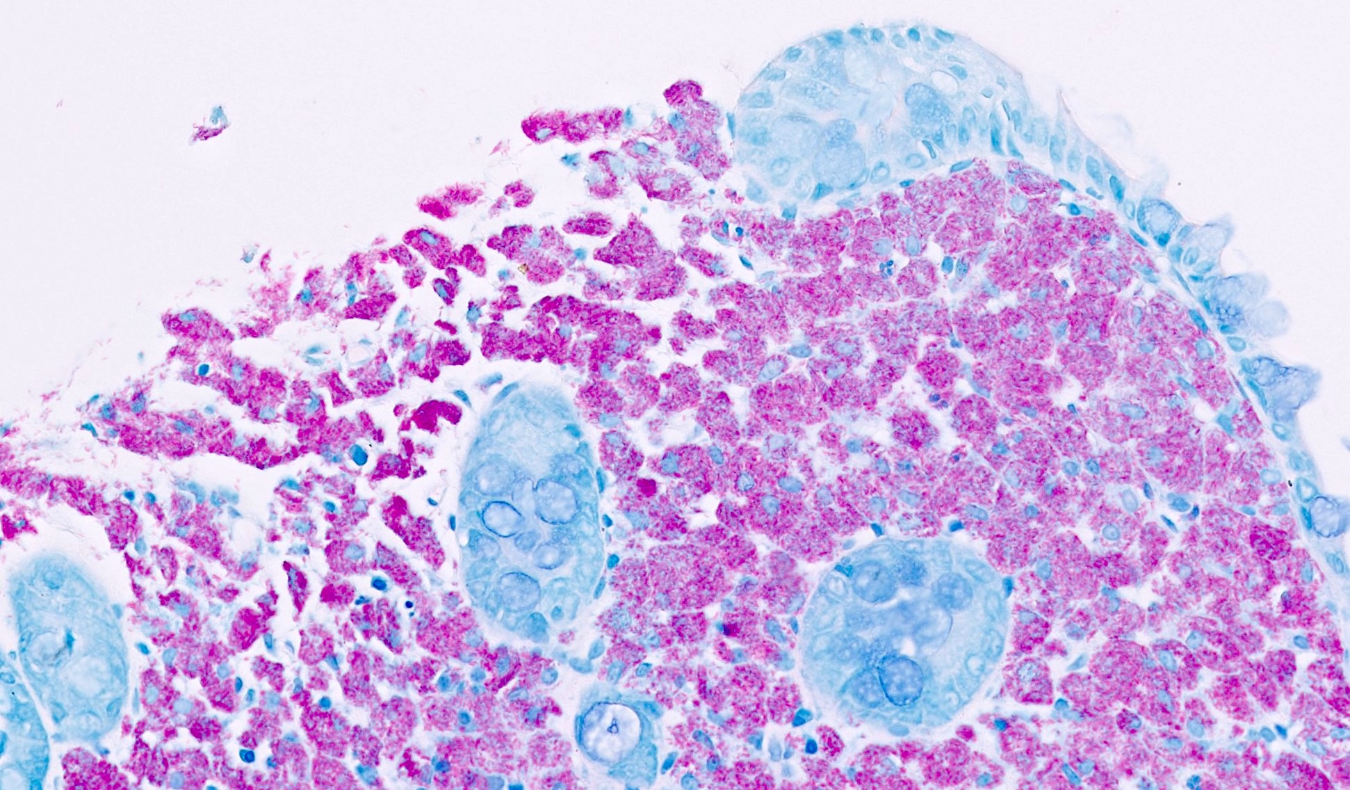 Pathology Outlines - Mycobacterium avium intracellulare