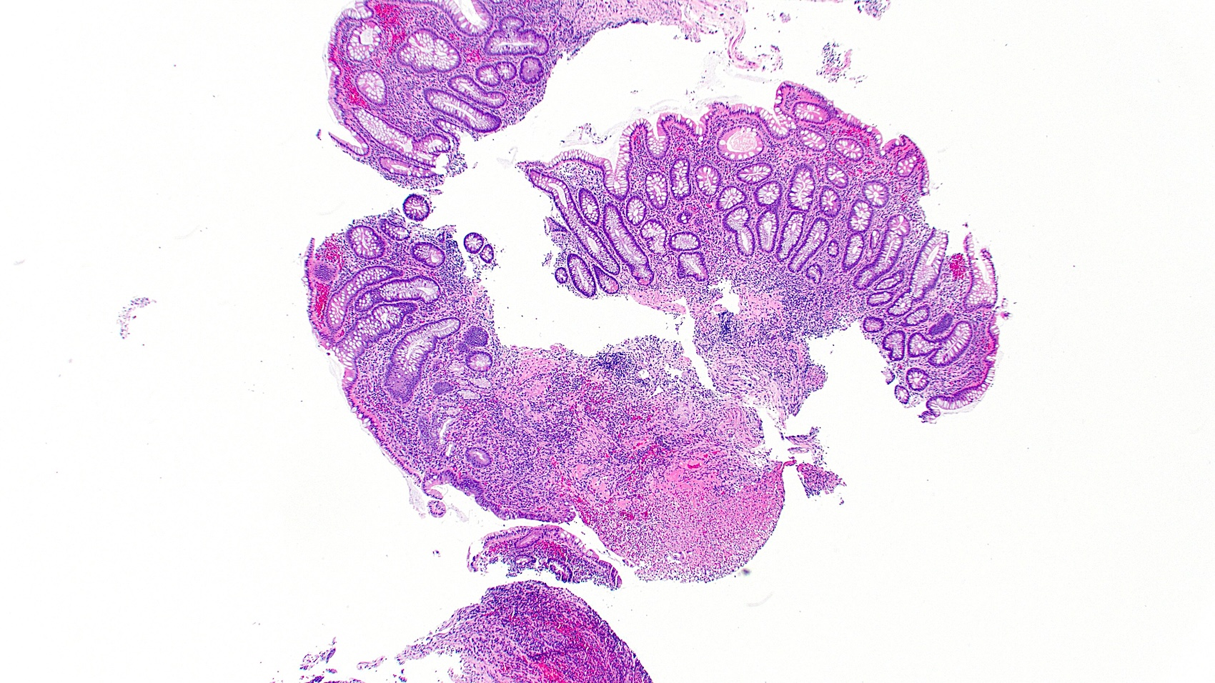 Pathology Outlines - NSAID associated colitis