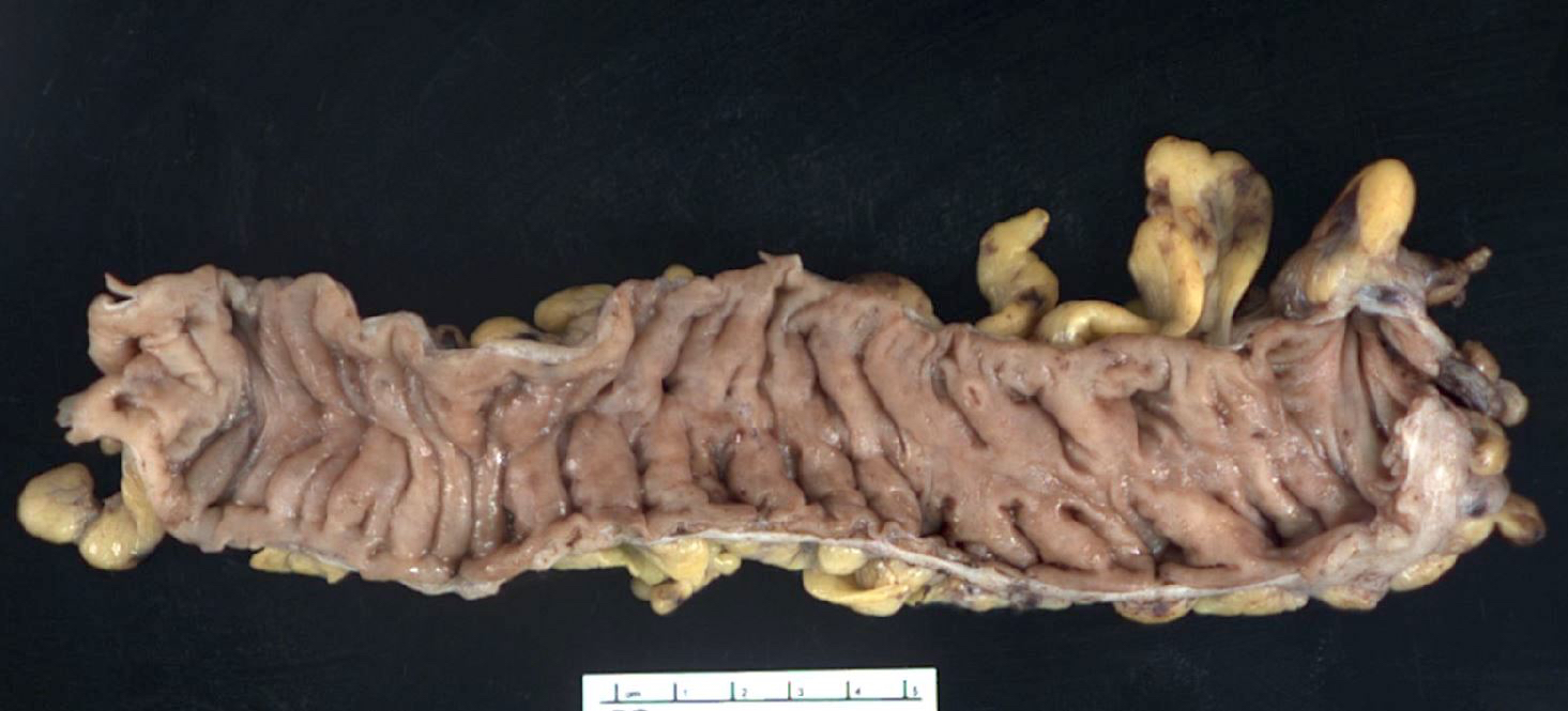 Pathology Outlines - Scleroderma