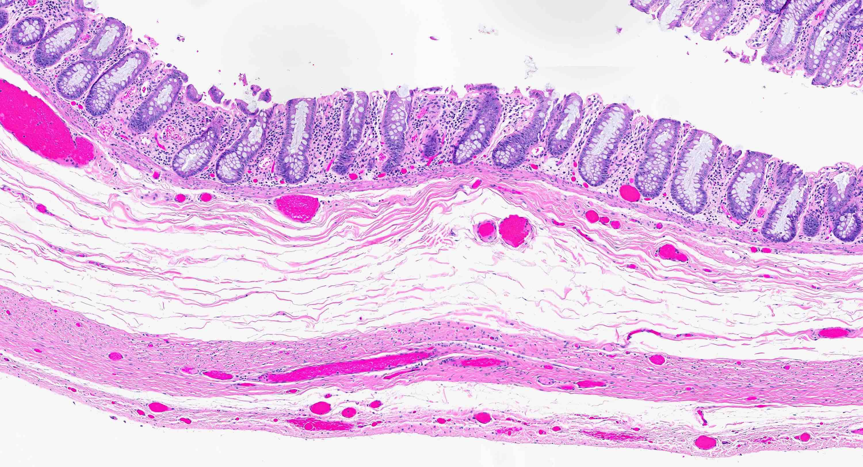Pathology Outlines - Scleroderma