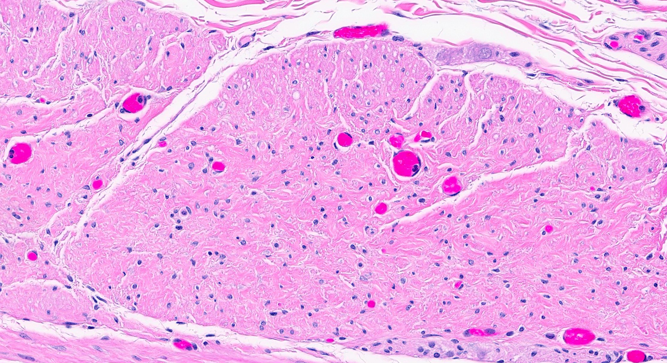 Pathology Outlines - Scleroderma
