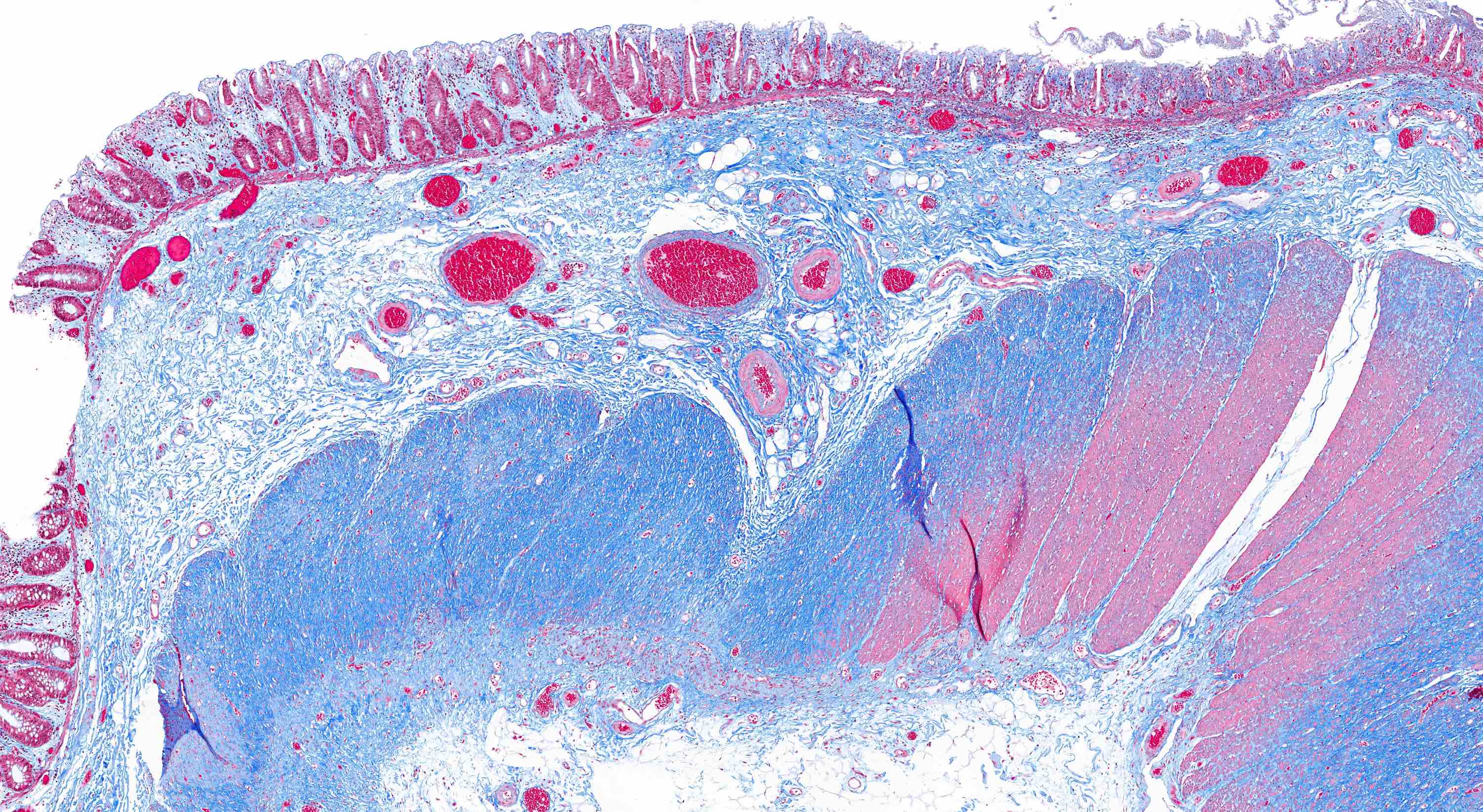 Pathology Outlines - Scleroderma
