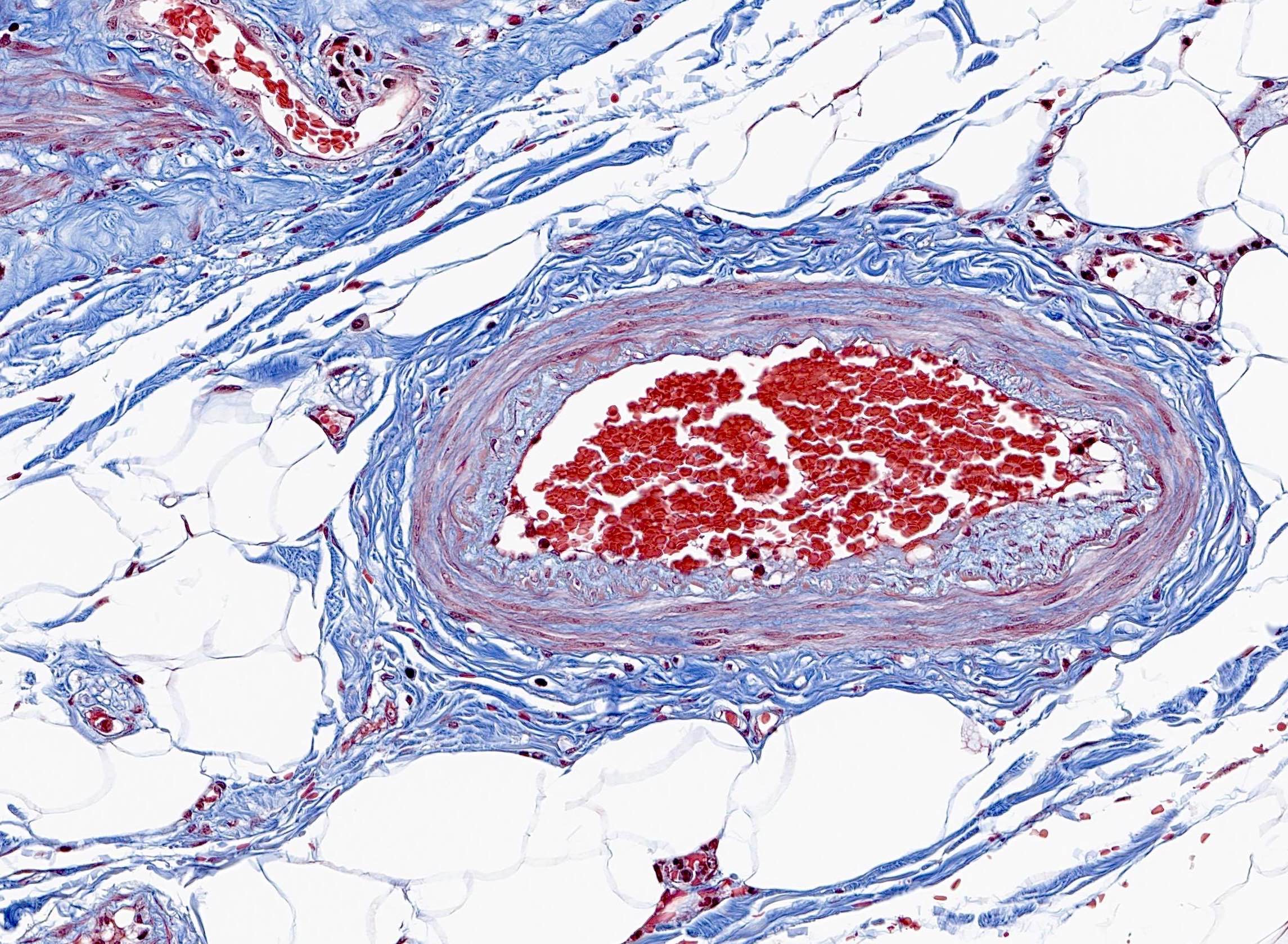 Pathology Outlines - Scleroderma