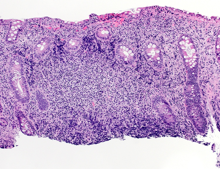 Pathology Outlines - Sexually transmitted infectious colitis / proctitis