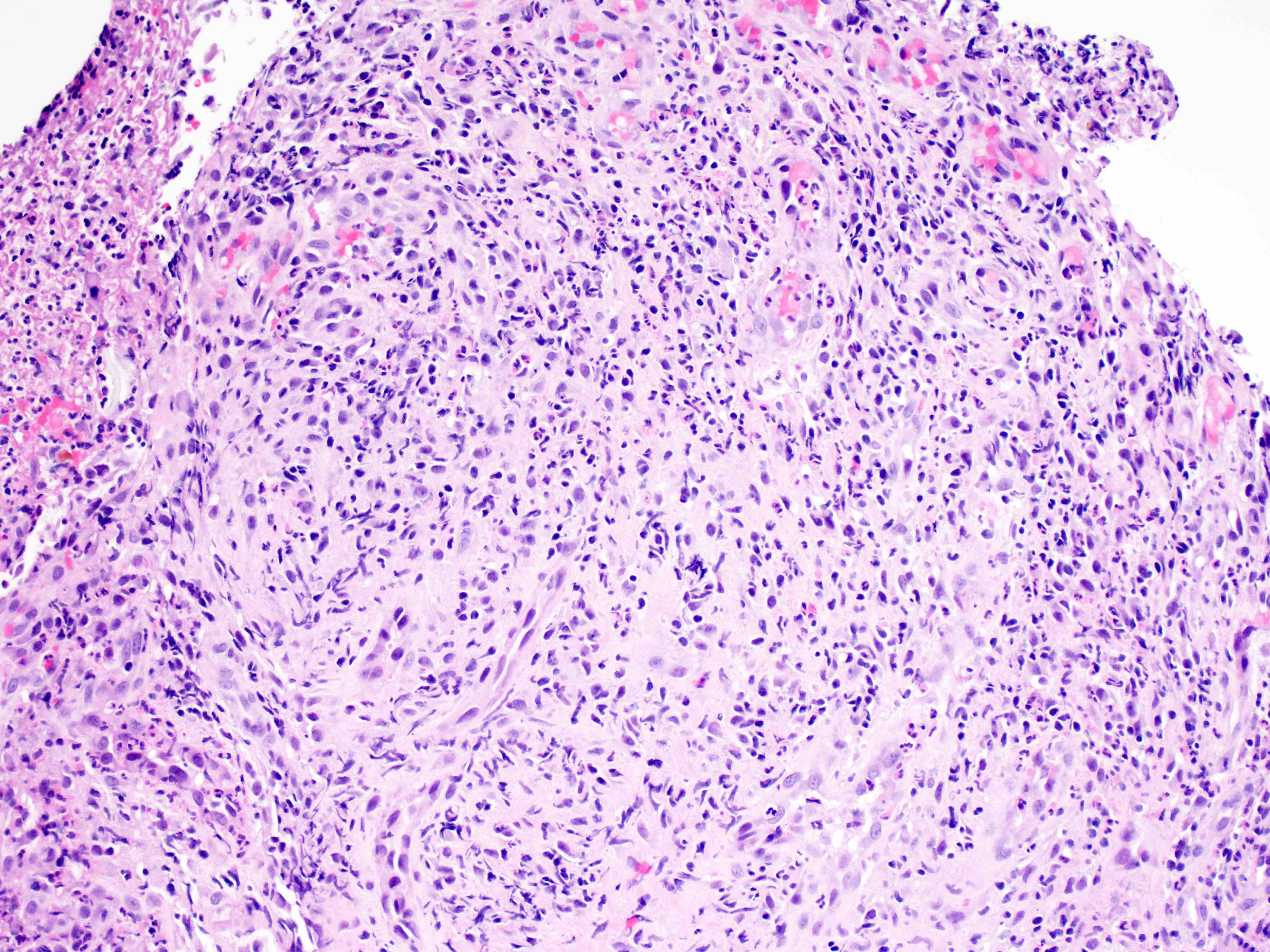 Pathology Outlines - Sexually transmitted infectious colitis / proctitis