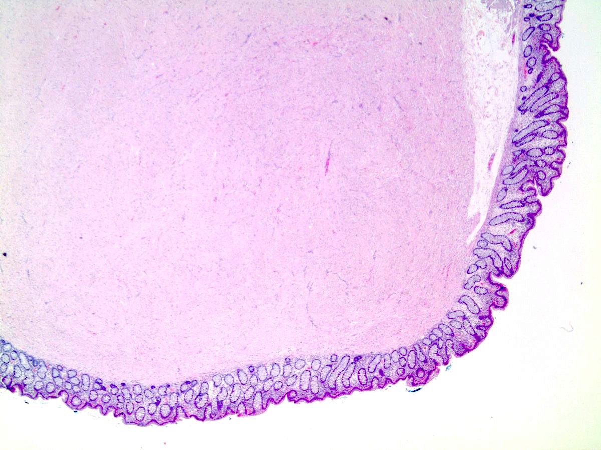 Pathology Outlines - Leiomyoma