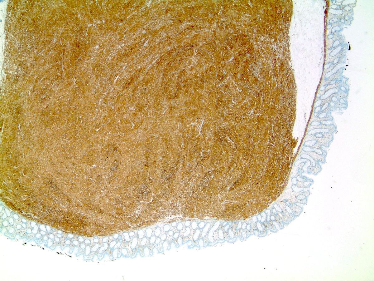 Pathology Outlines - Leiomyoma
