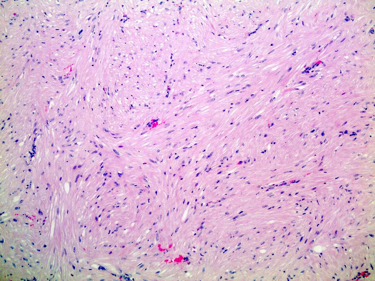 Pathology Outlines - Leiomyoma