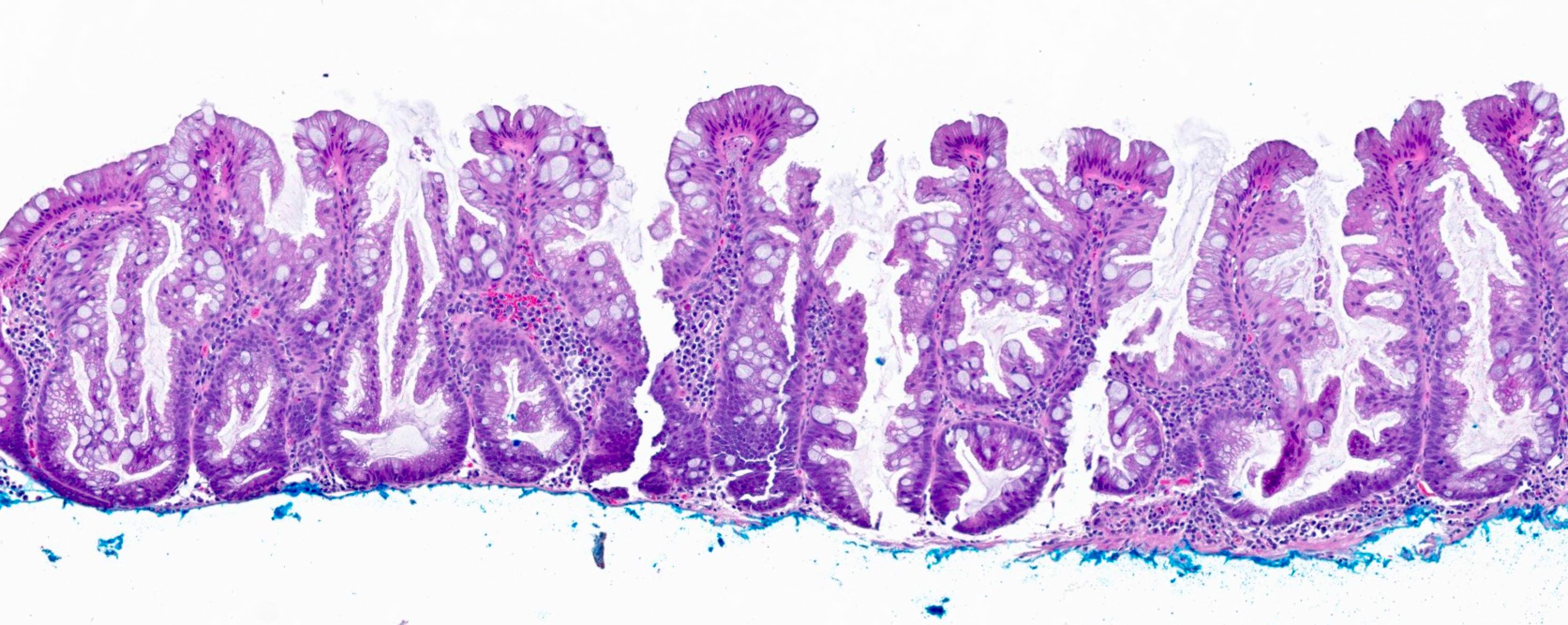 Qiao39s Pathology Sessile Serrated Adenoma Of The Colon