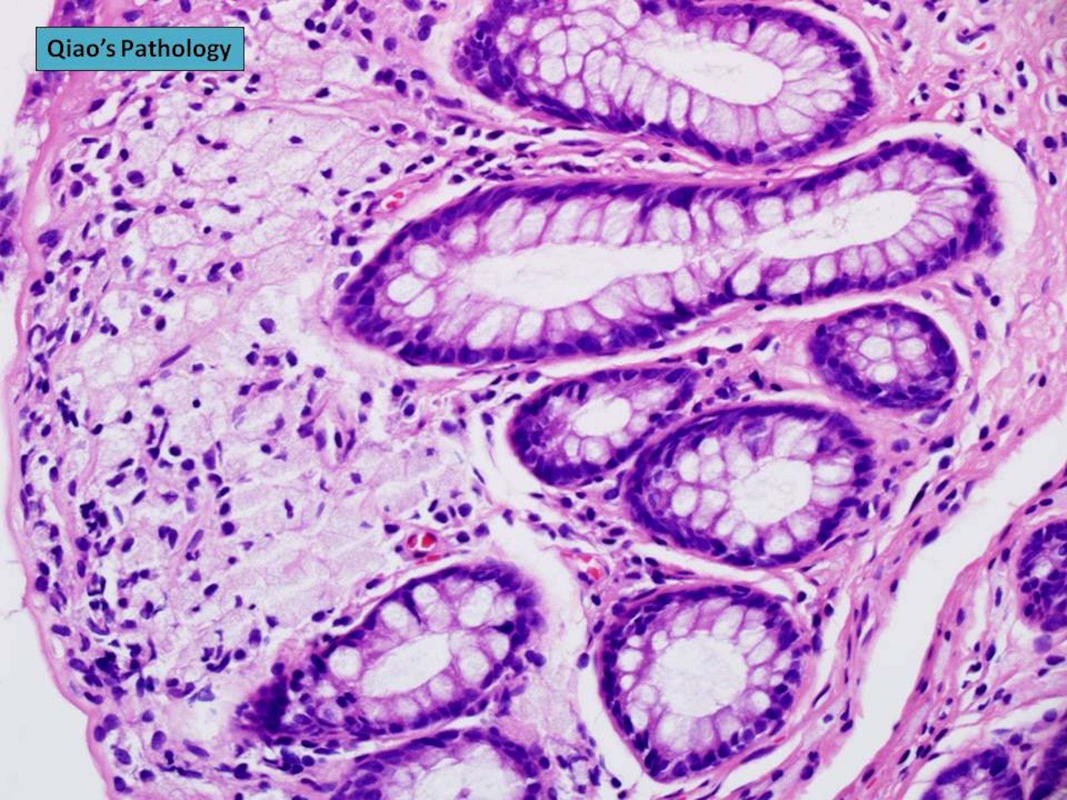 Pathology Outlines - Xanthoma