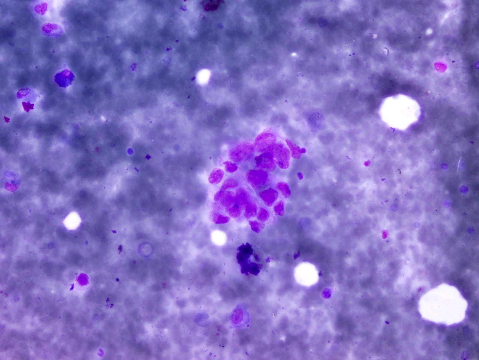 Pathology Outlines - Suspicious for malignancy
