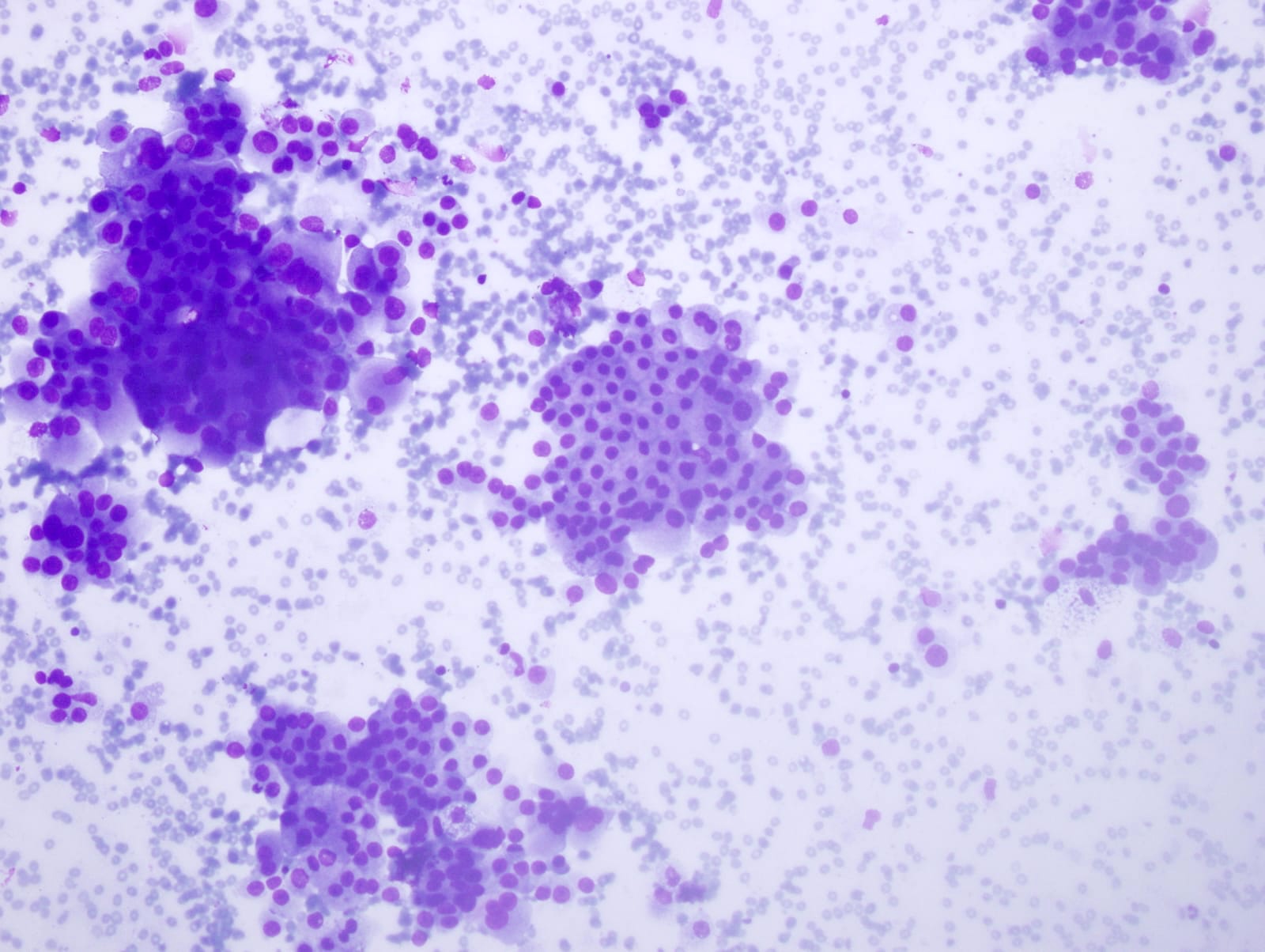 Pathology Outlines - Suspicious for malignancy